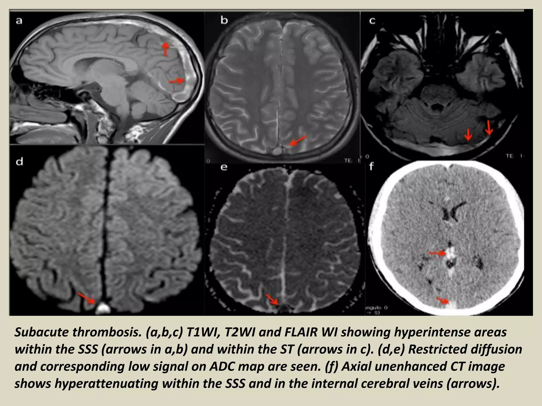 Presentation1.pptx, radiological imaging of cerebral venous thrombosis ...