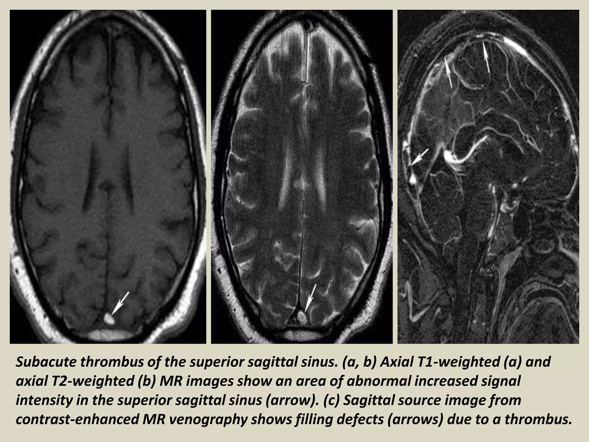 Presentation1.pptx, radiological imaging of cerebral venous thrombosis ...
