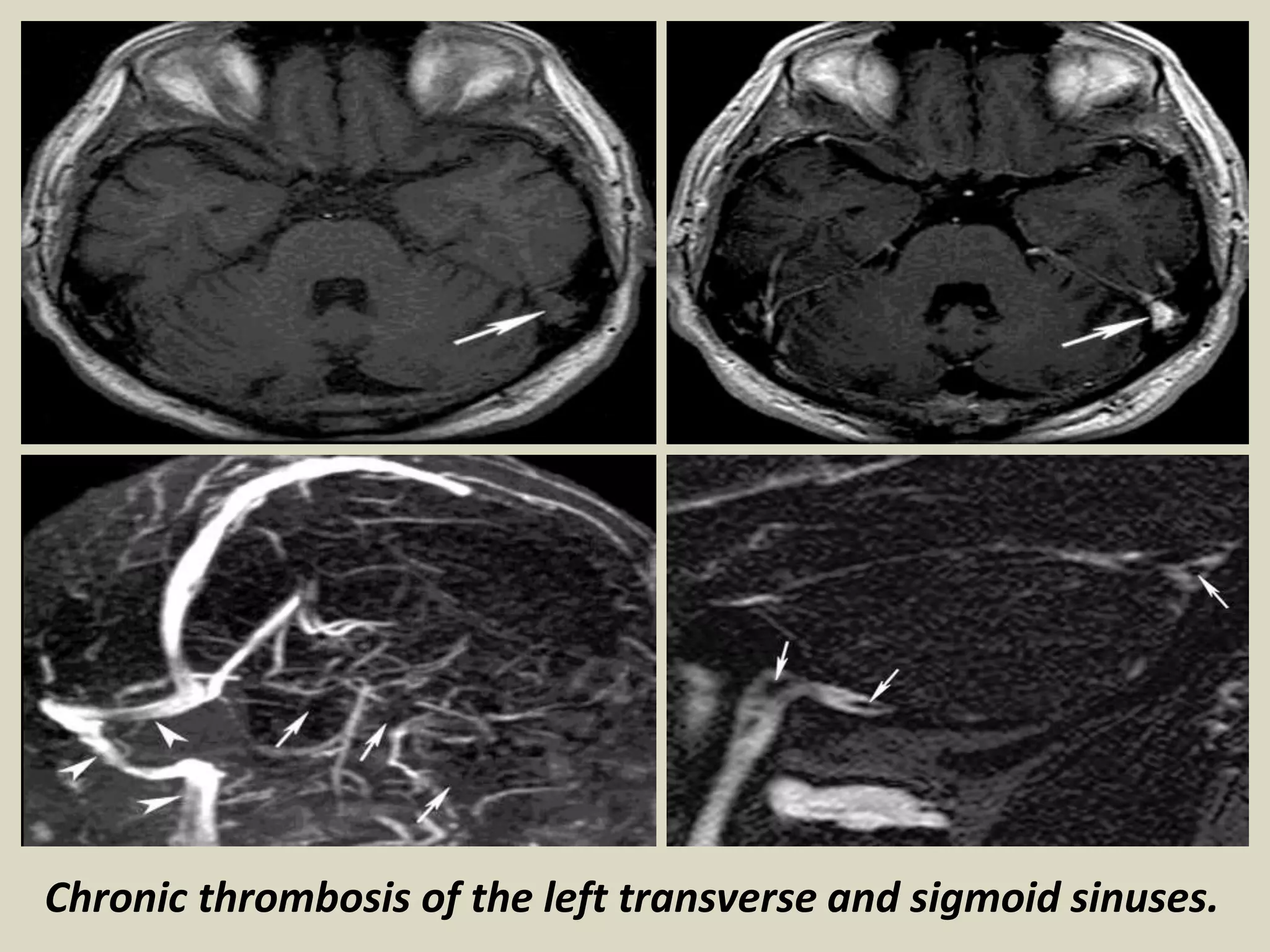 Presentation1.pptx, radiological imaging of cerebral venous thrombosis ...