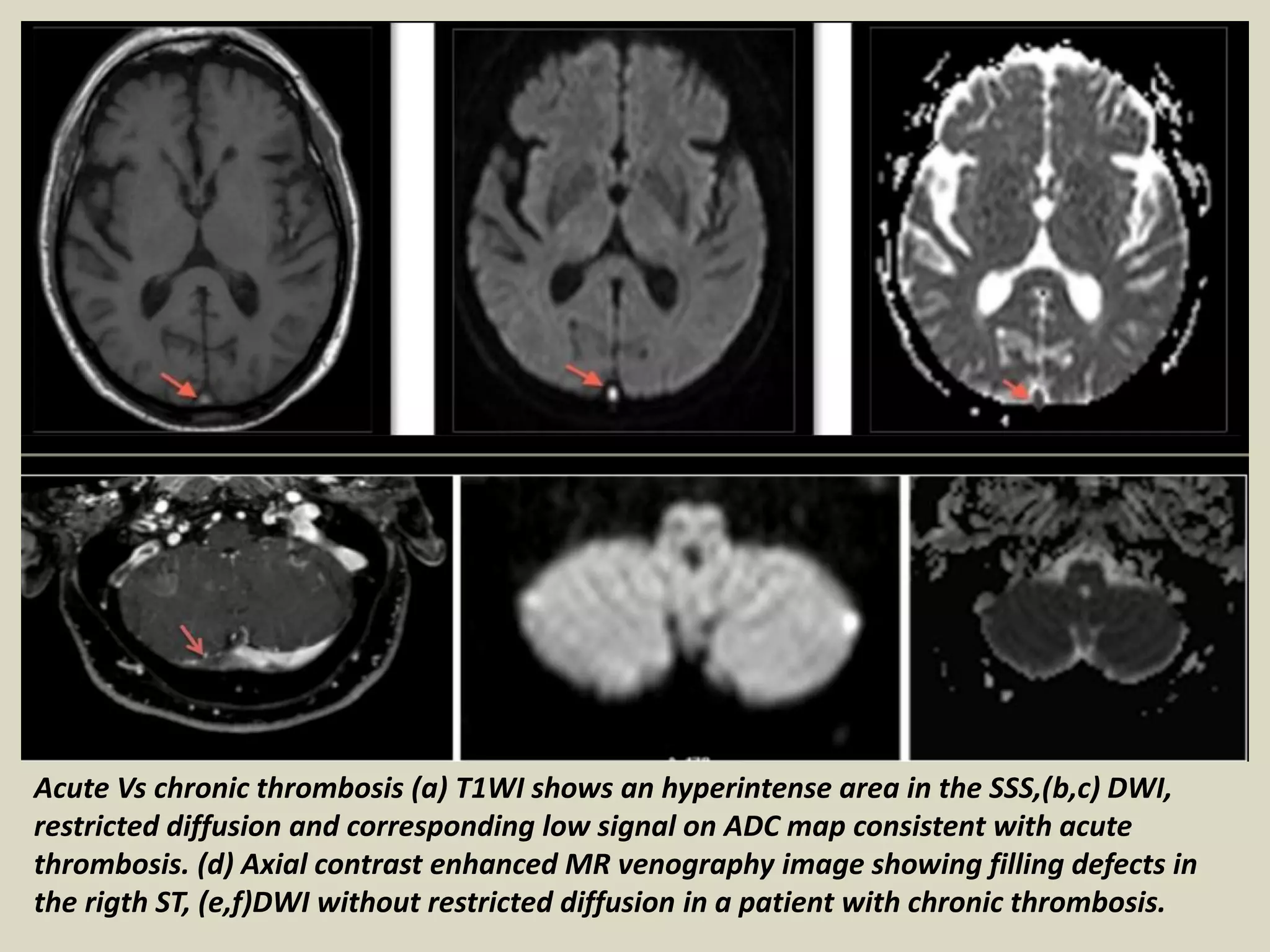 Presentation1.pptx, radiological imaging of cerebral venous thrombosis ...
