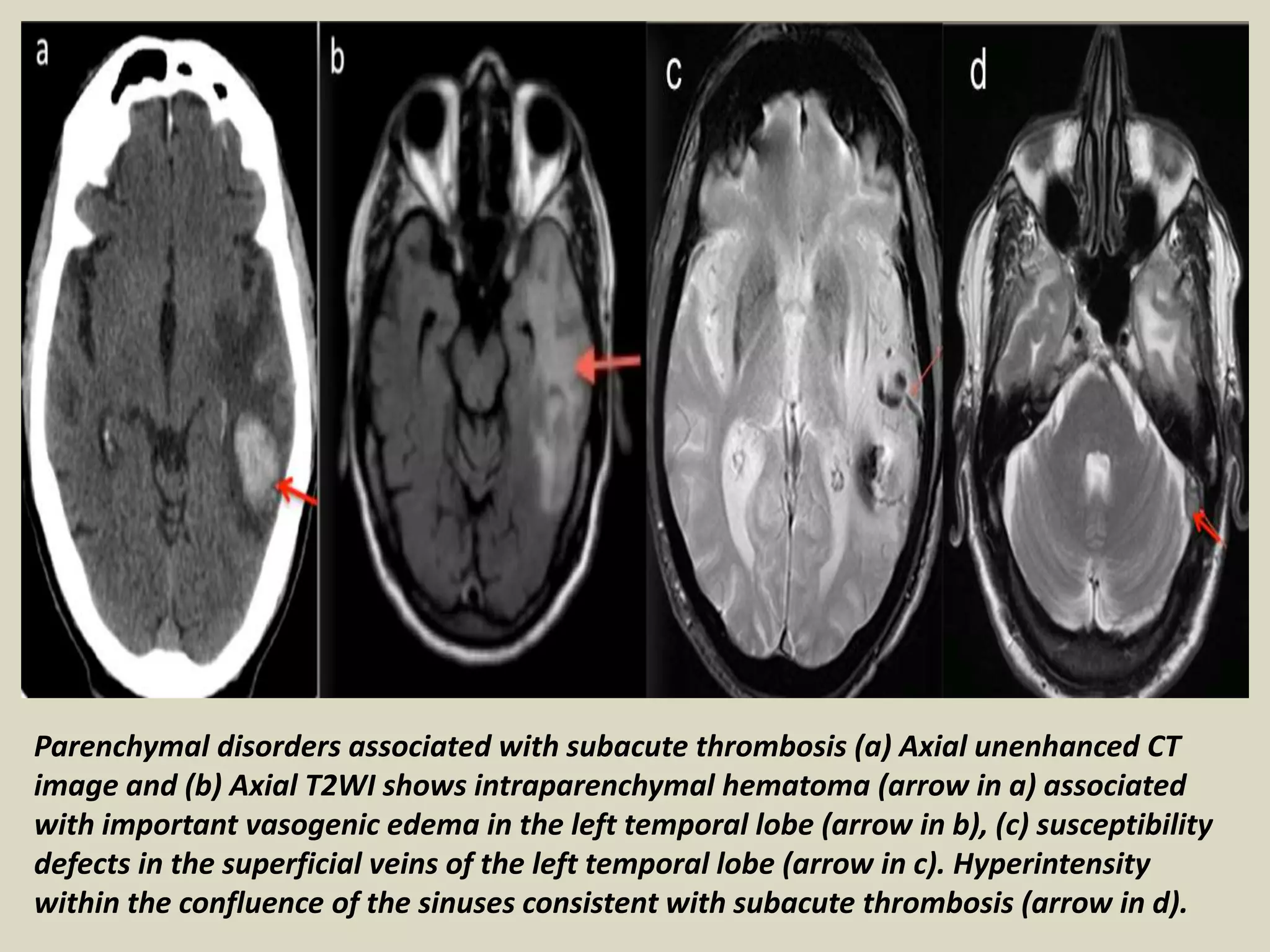 Presentation1.pptx, radiological imaging of cerebral venous thrombosis ...