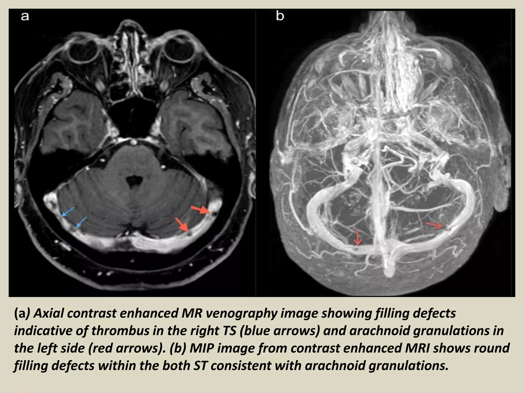 Presentation1.pptx, radiological imaging of cerebral venous thrombosis ...