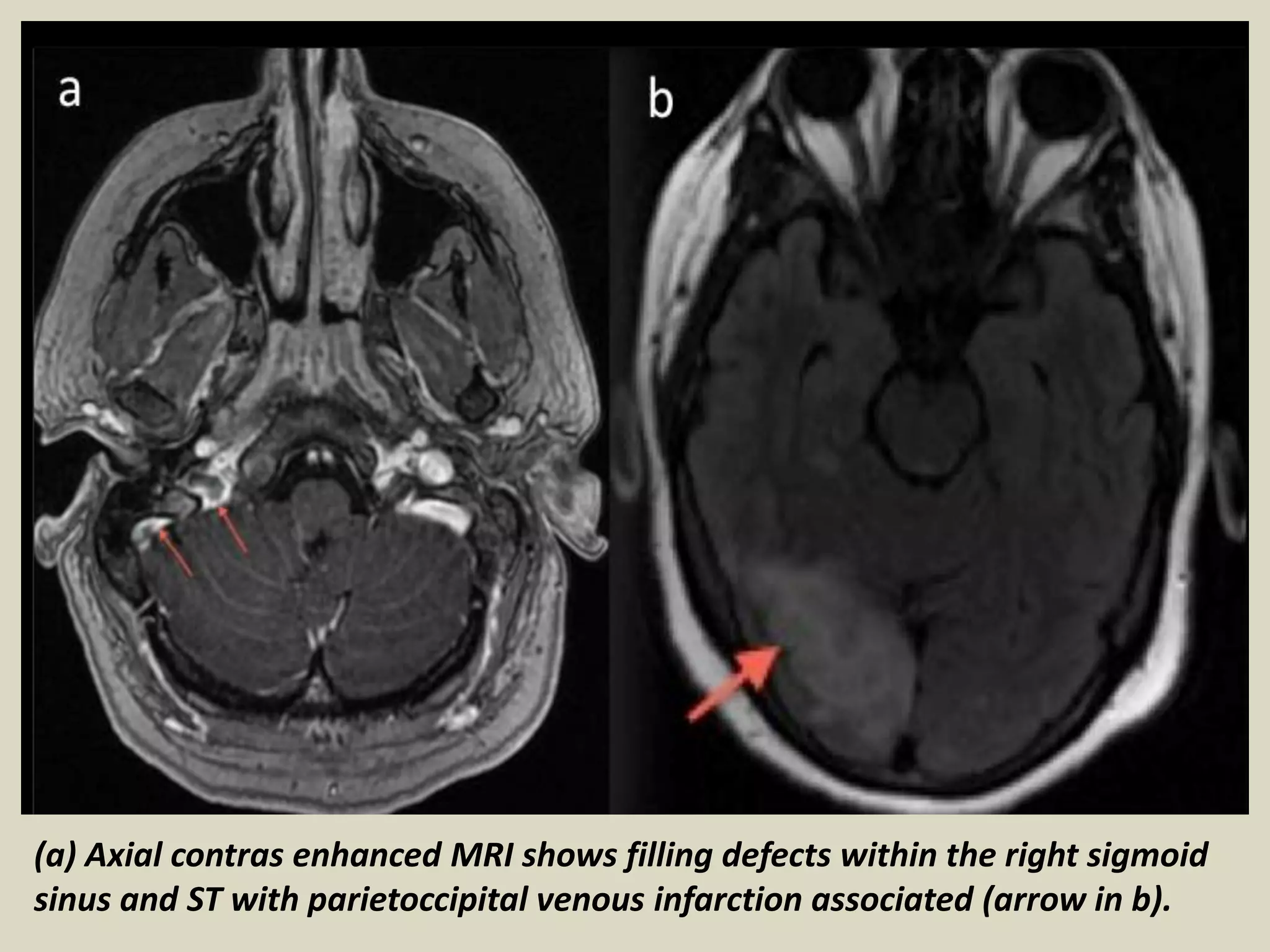 Presentation1.pptx, radiological imaging of cerebral venous thrombosis ...