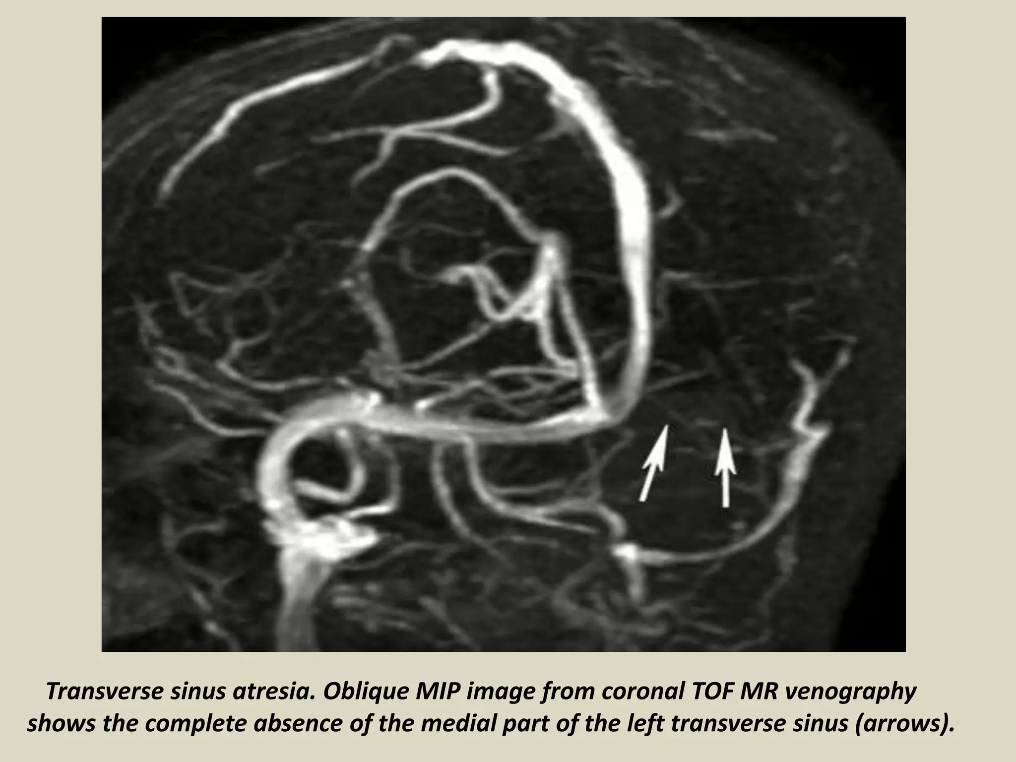 Presentation1.pptx, radiological imaging of cerebral venous thrombosis ...