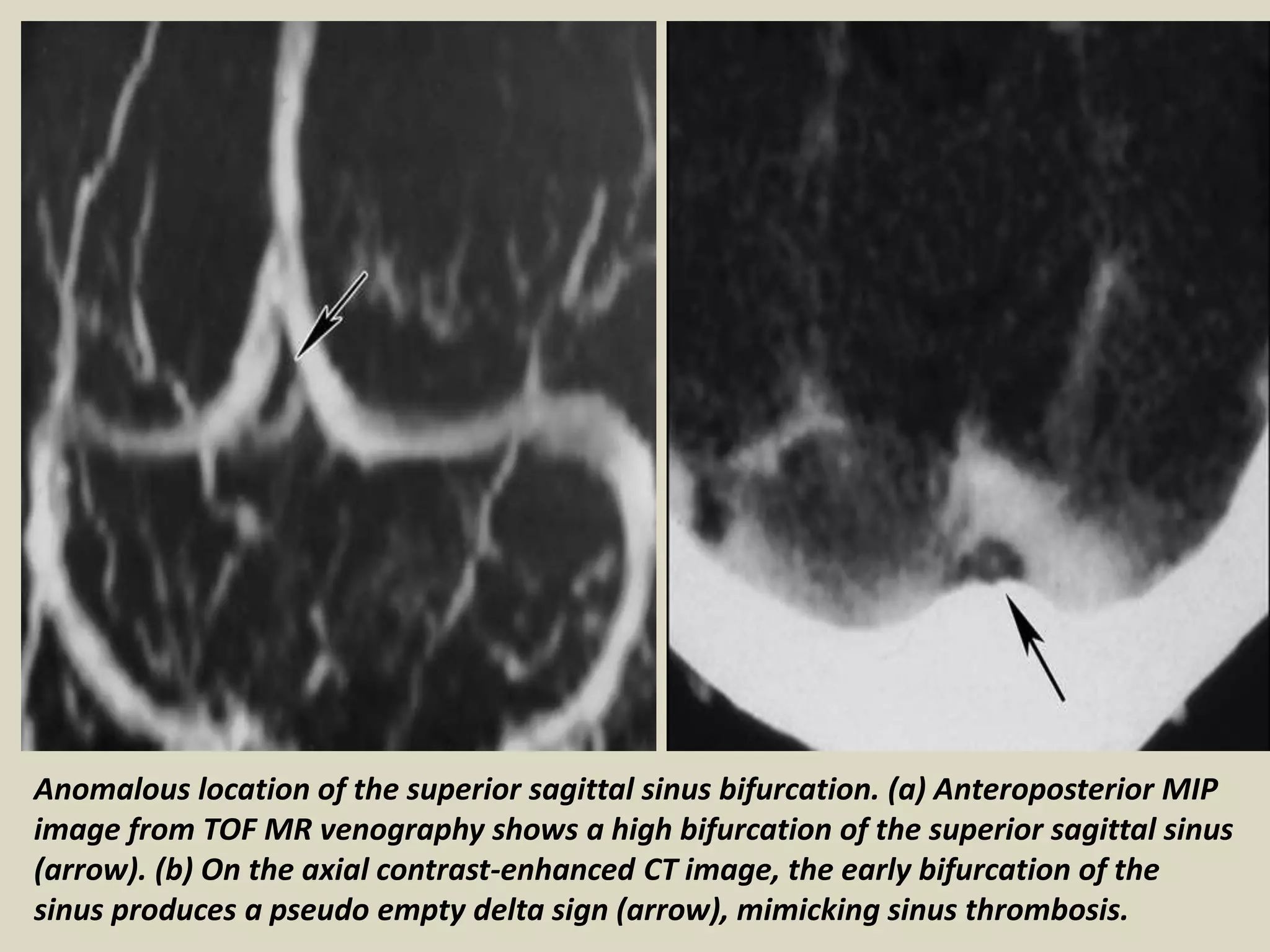 Presentation1.pptx, radiological imaging of cerebral venous thrombosis ...