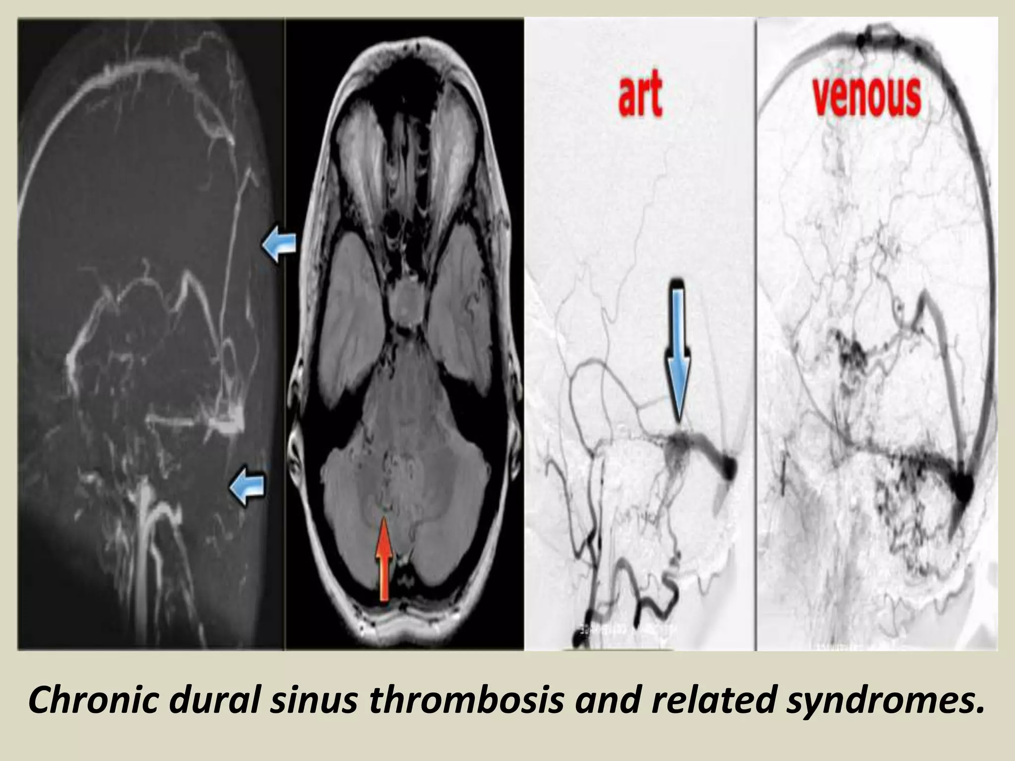 Presentation1.pptx, radiological imaging of cerebral venous thrombosis ...