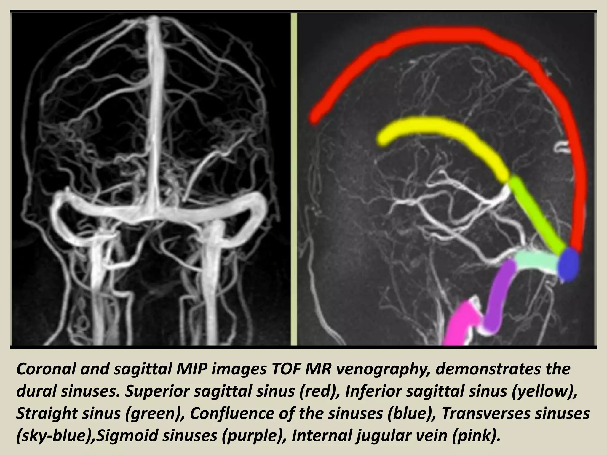 Presentation1.pptx, radiological imaging of cerebral venous thrombosis ...