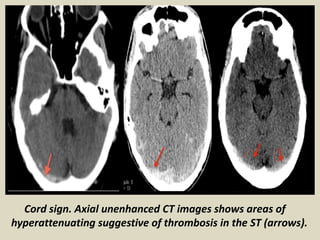 Presentation1.pptx, radiological imaging of cerebral venous thrombosis ...