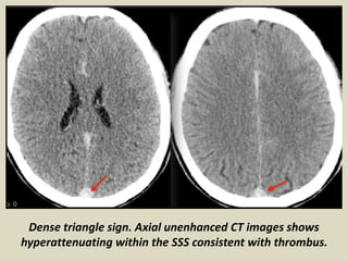 Presentation1.pptx, radiological imaging of cerebral venous thrombosis ...