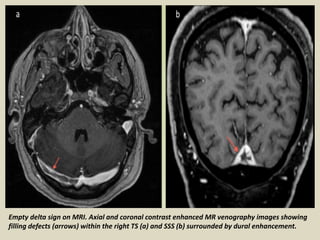 Presentation1.pptx, radiological imaging of cerebral venous thrombosis ...
