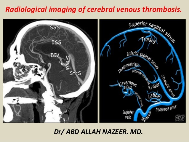 Venous Sinus Thrombosis Radiology At St Vincent S Uni