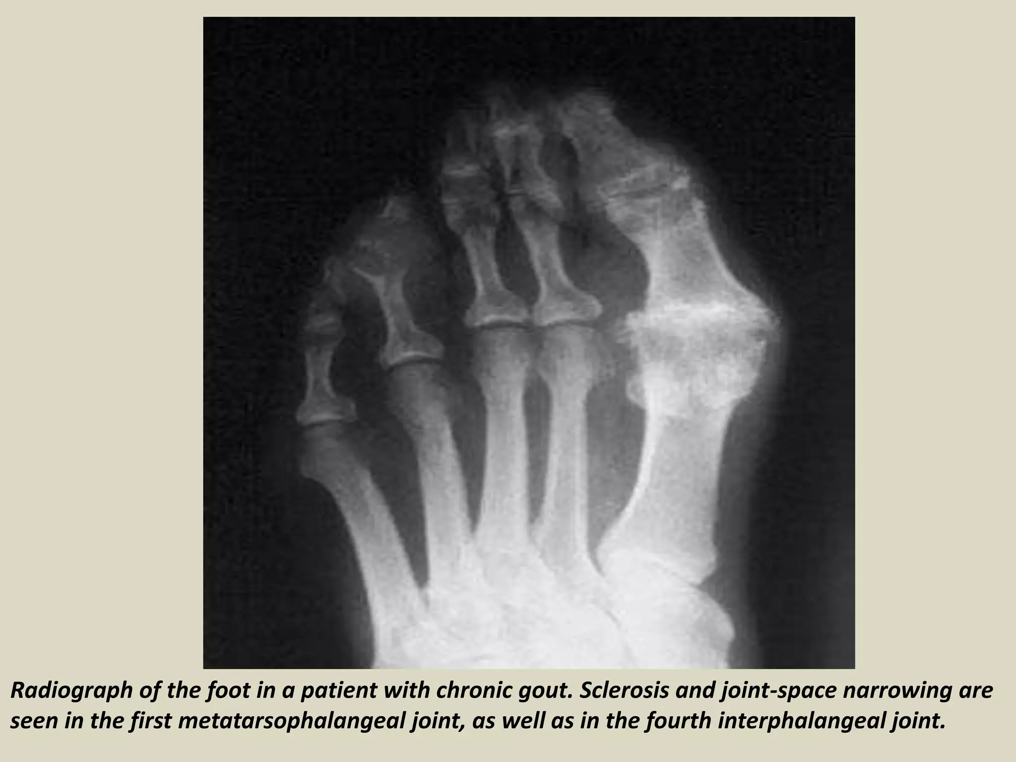 Presentation1.pptx, radiological imaging of gout disease. | PPTX