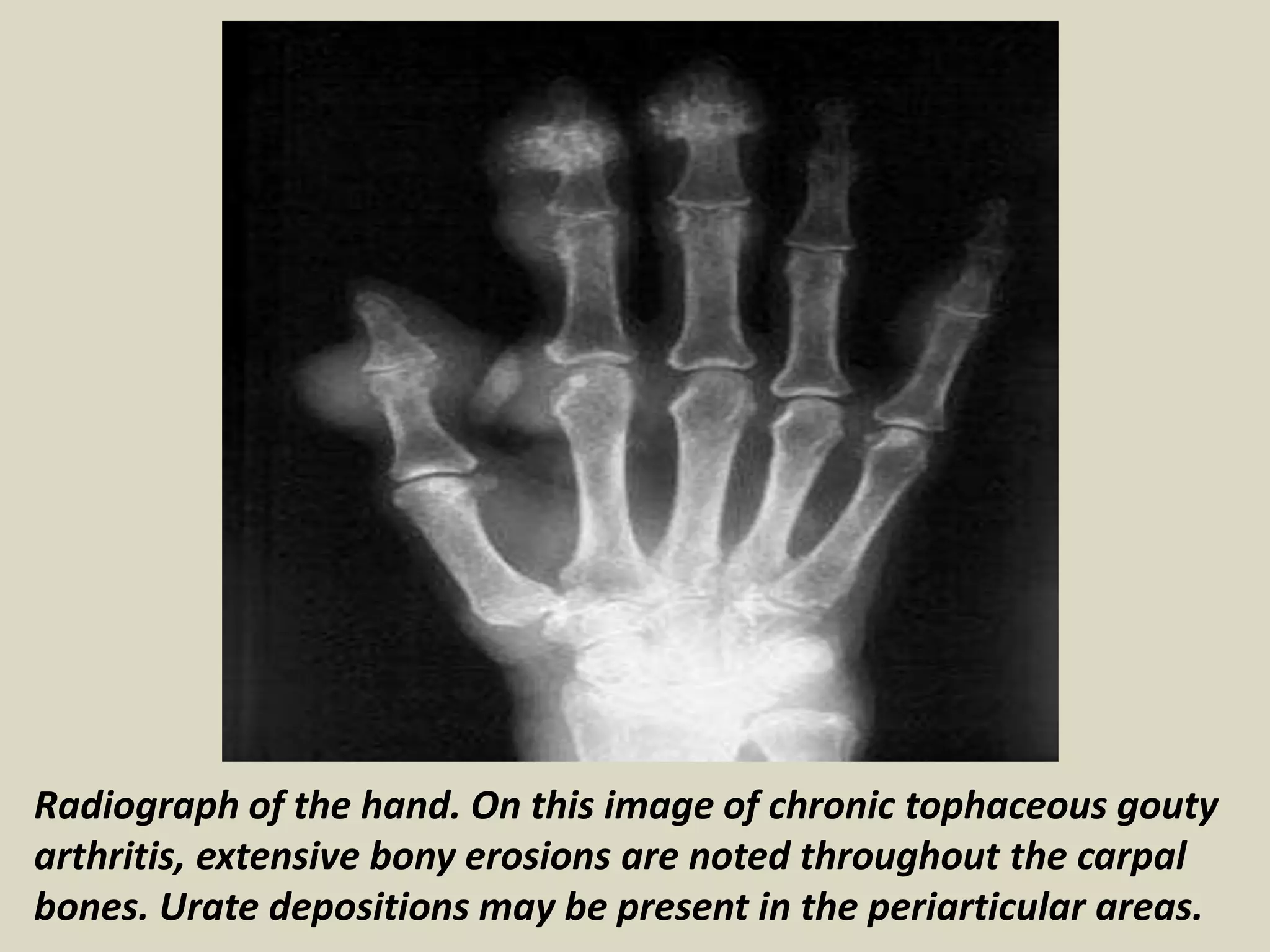 Presentation1.pptx, radiological imaging of gout disease. | PPTX