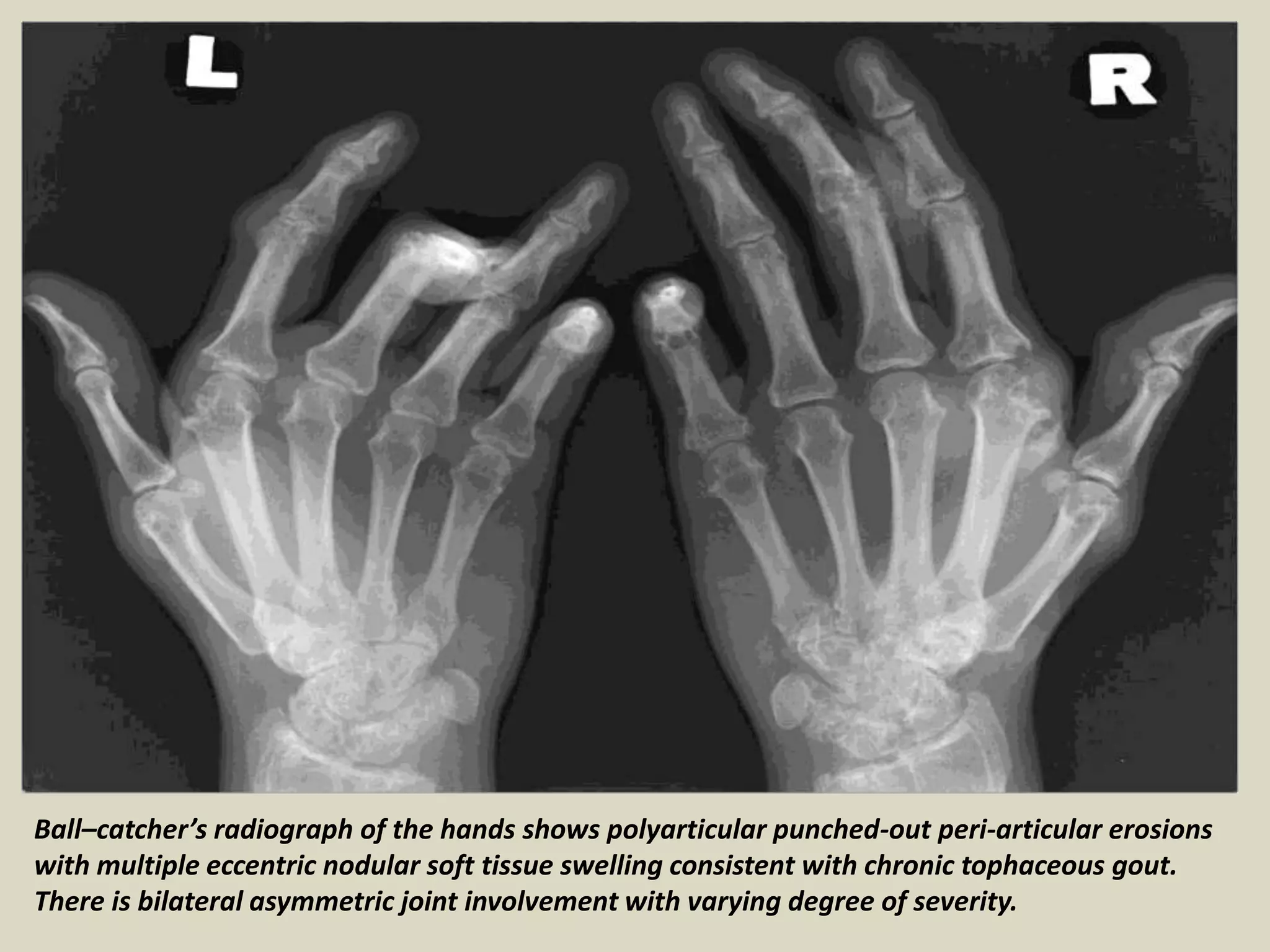 Presentation1.pptx, radiological imaging of gout disease. | PPTX