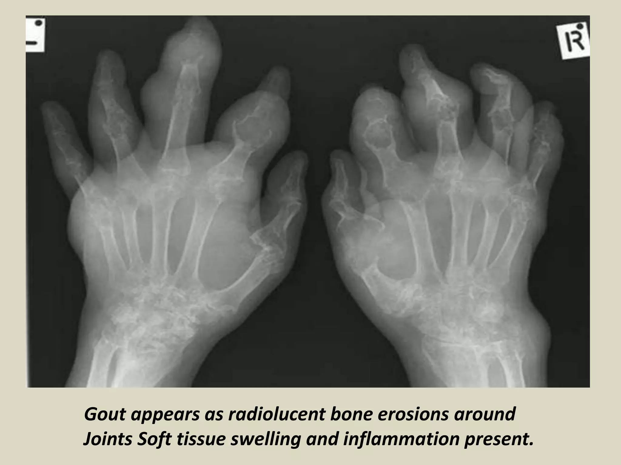 Presentation1.pptx, radiological imaging of gout disease. | PPTX