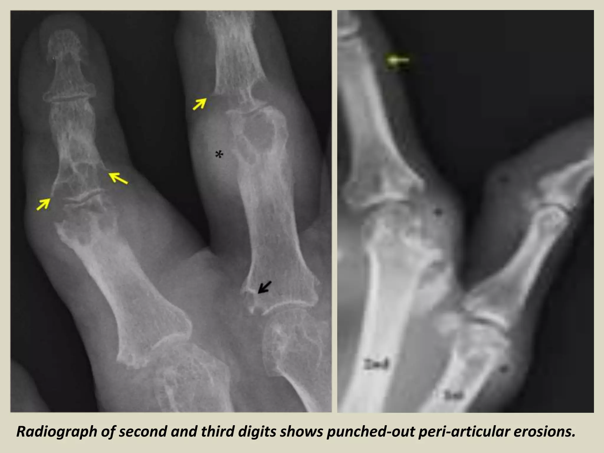 Presentation1.pptx, radiological imaging of gout disease. | PPTX