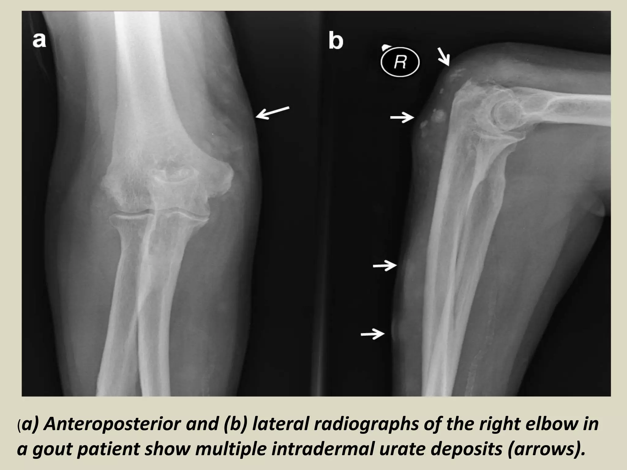 Presentation1.pptx, radiological imaging of gout disease. | PPTX