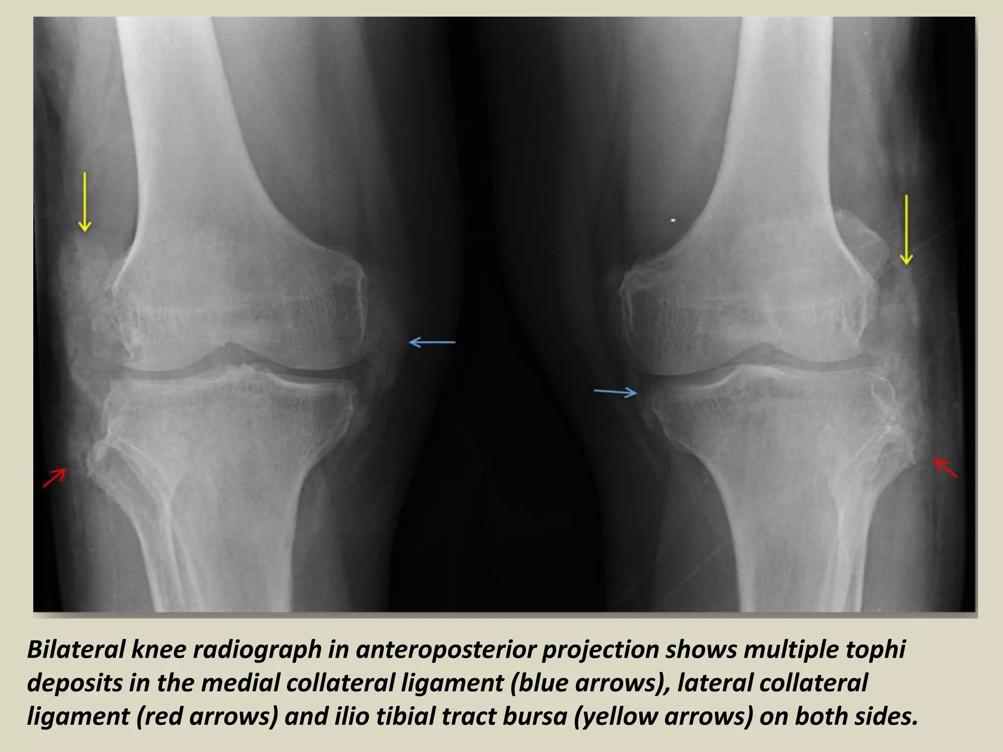 Presentation1.pptx, radiological imaging of gout disease. | PPTX