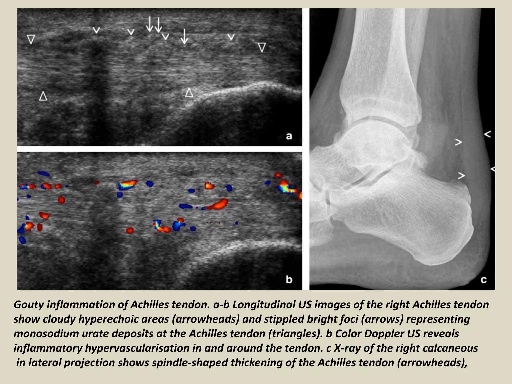 Presentation1.pptx, radiological imaging of gout disease. | PPTX