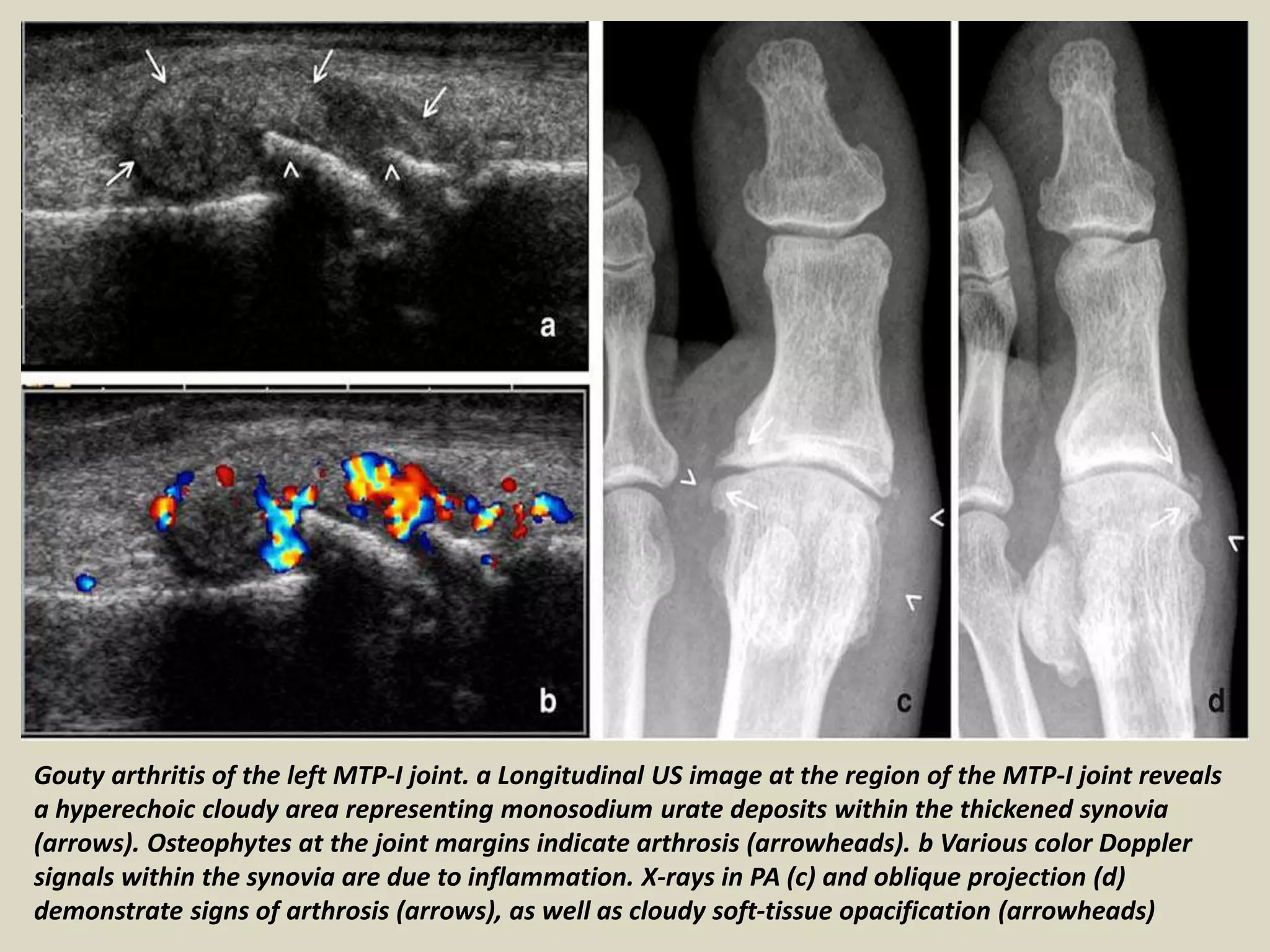 Presentation1.pptx, radiological imaging of gout disease. | PPTX