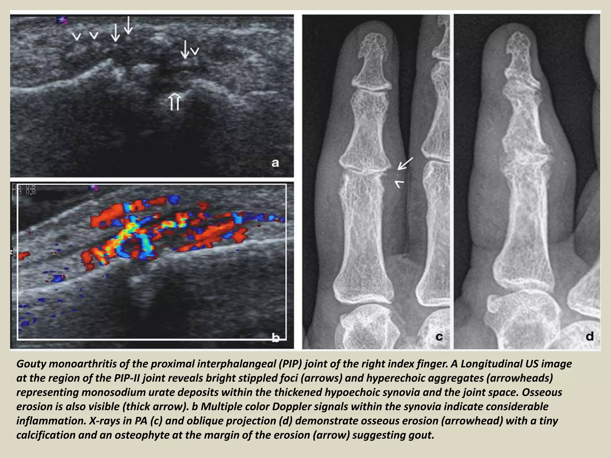 Presentation1.pptx, radiological imaging of gout disease. | PPTX