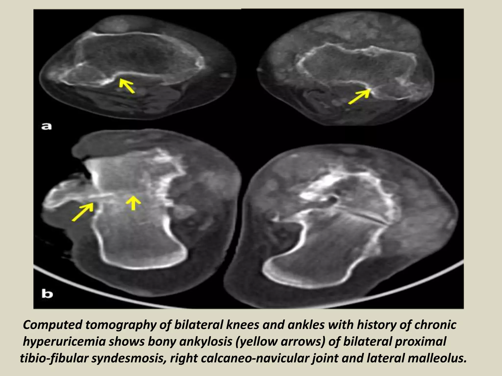 Presentation1.pptx, radiological imaging of gout disease. | PPTX