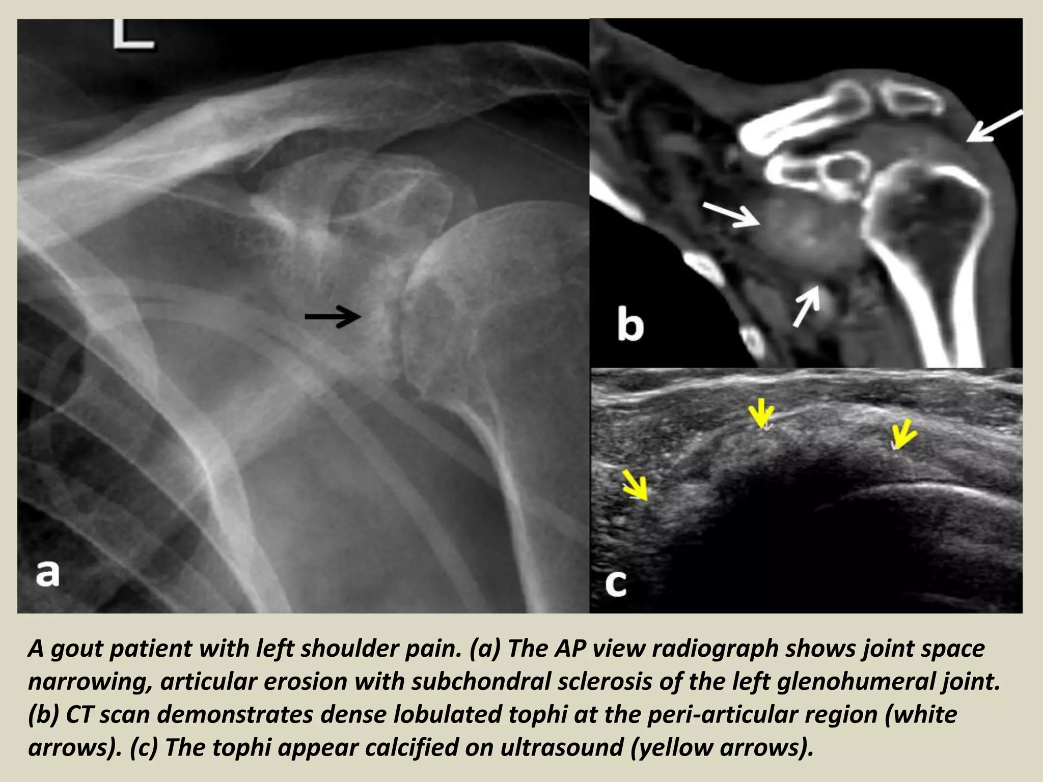 Presentation1.pptx, radiological imaging of gout disease. | PPTX
