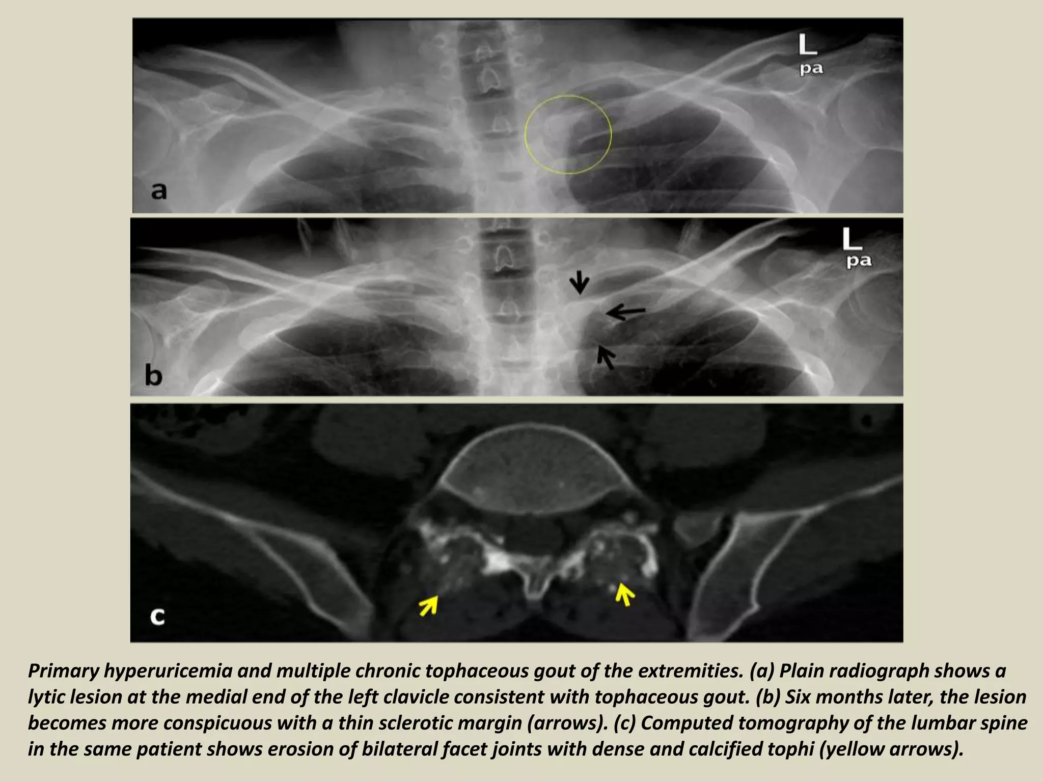 Presentation1.pptx, radiological imaging of gout disease. | PPTX