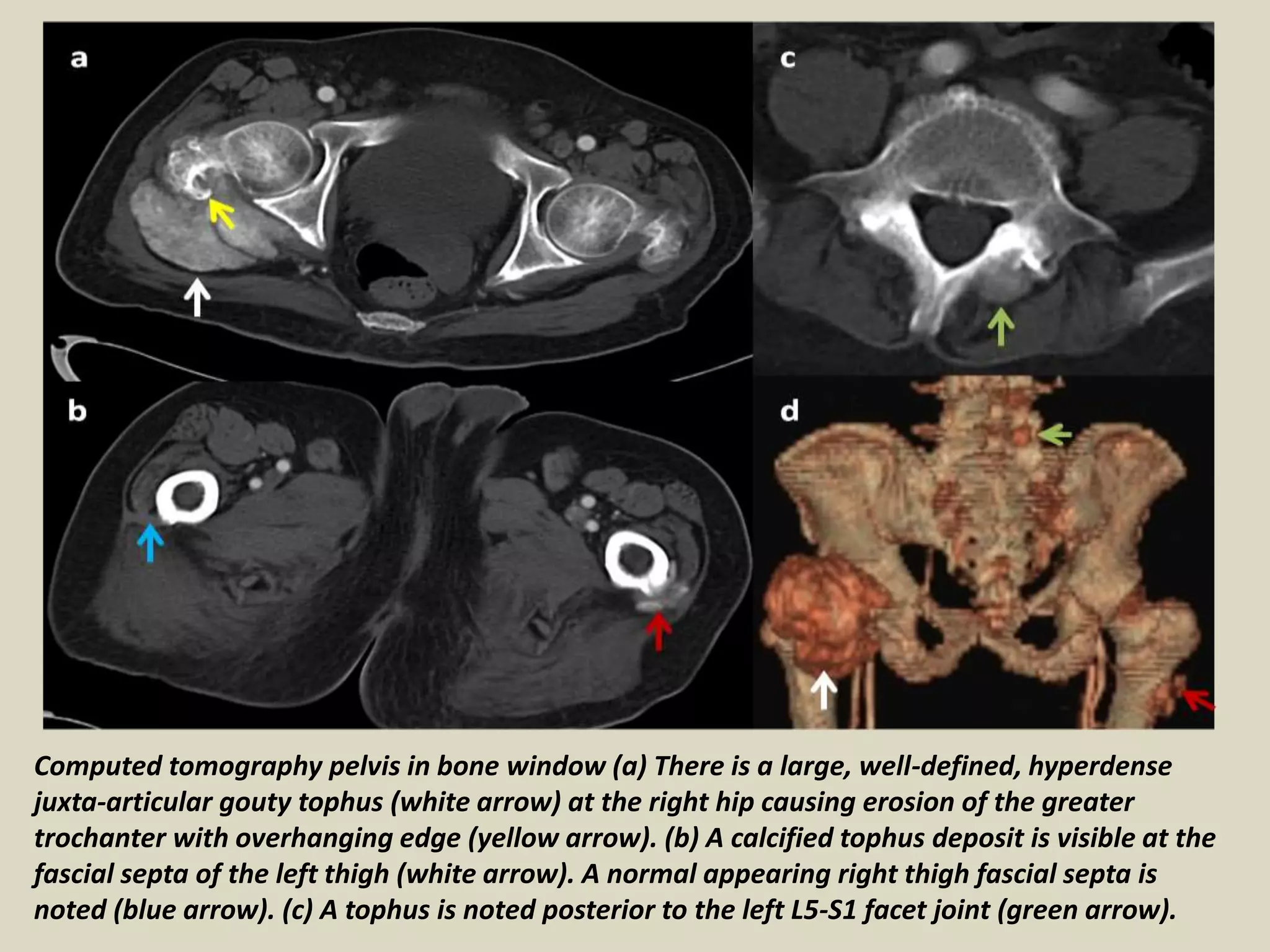 Presentation1.pptx, radiological imaging of gout disease. | PPTX