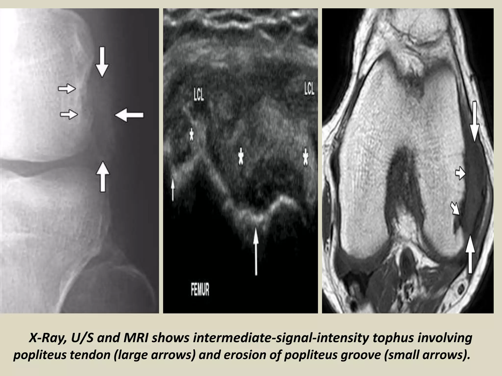 Presentation1.pptx, radiological imaging of gout disease. | PPTX