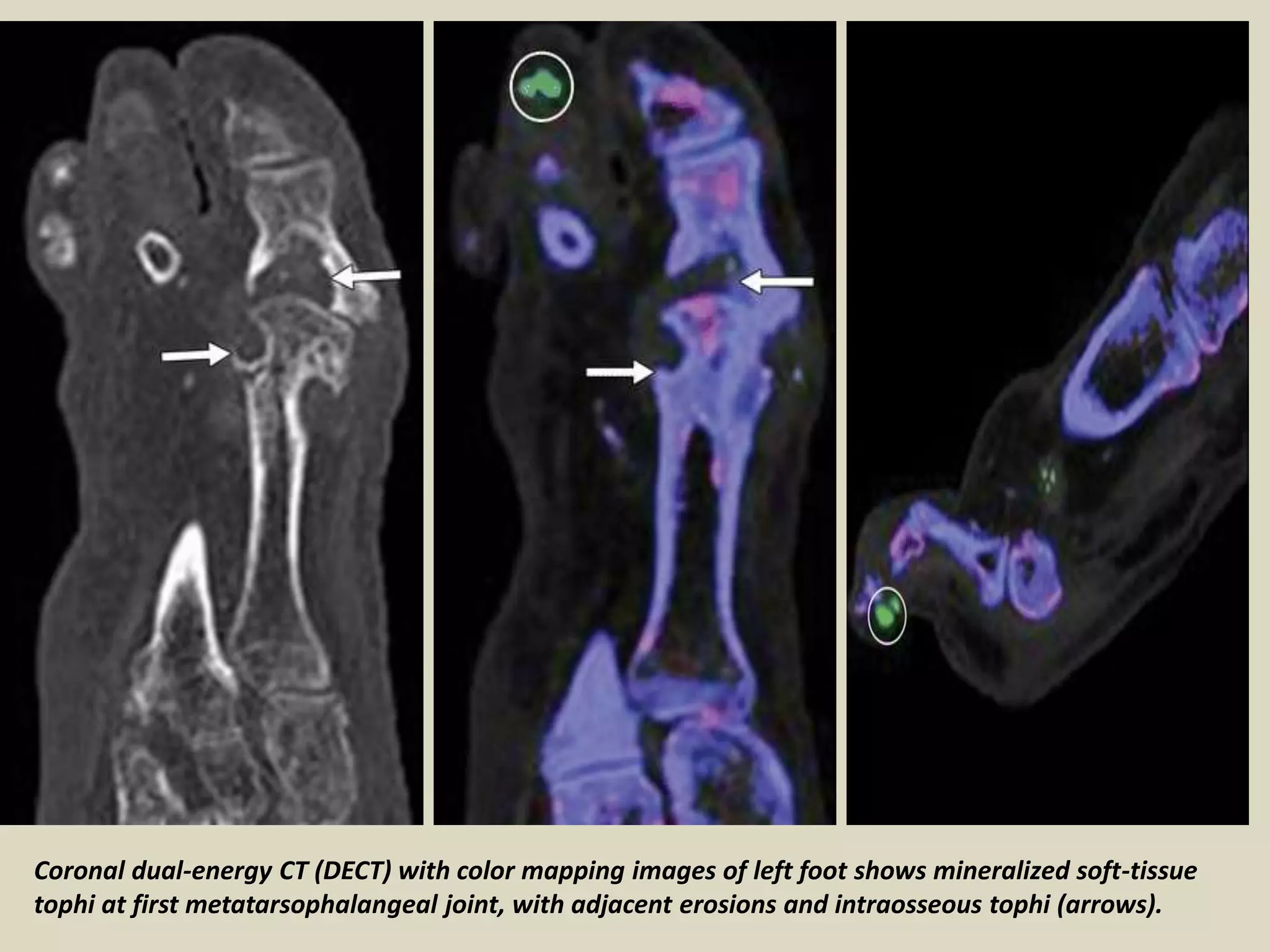 Presentation1.pptx, radiological imaging of gout disease. | PPTX