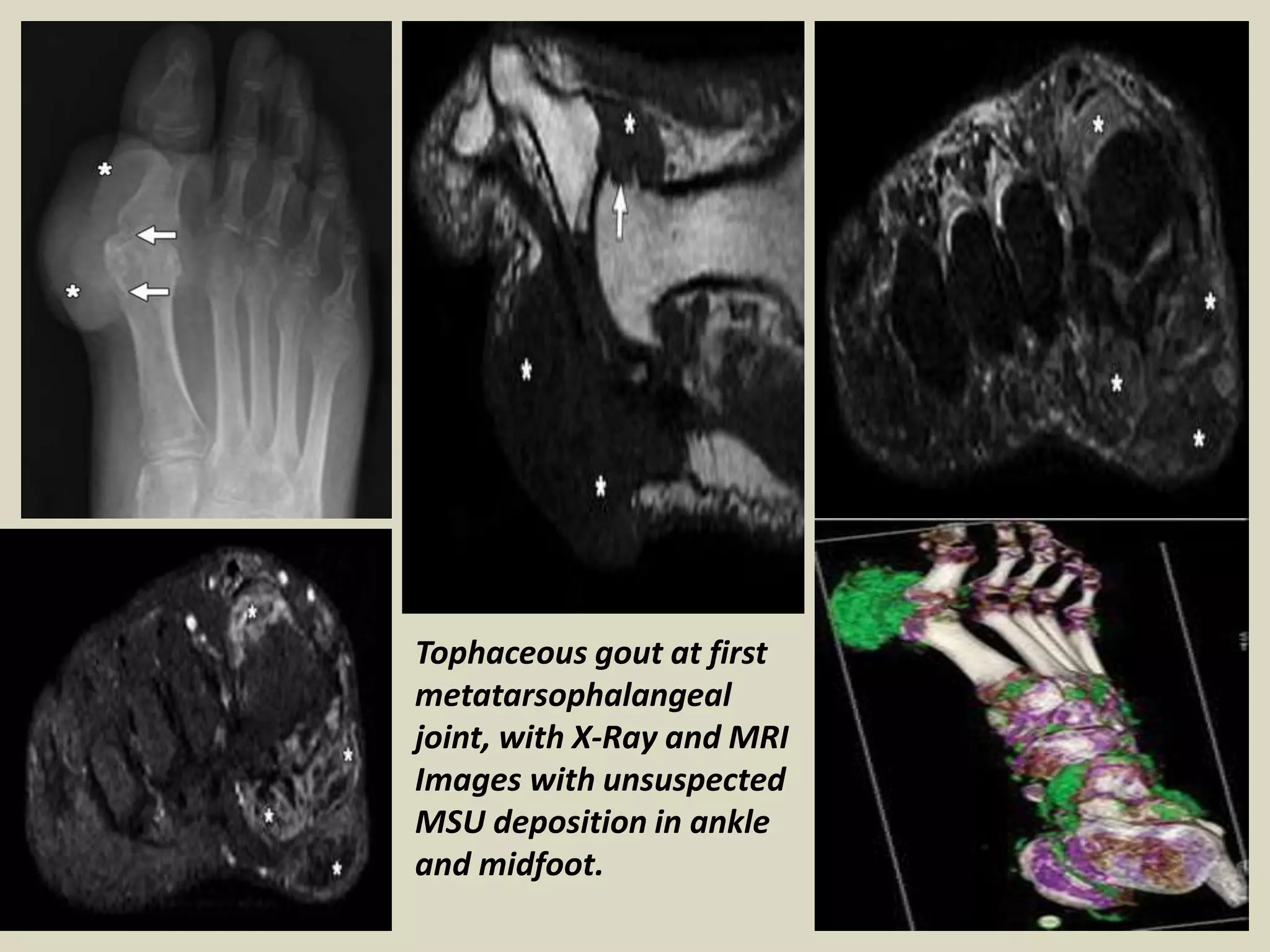 Presentation1.pptx, radiological imaging of gout disease. | PPTX