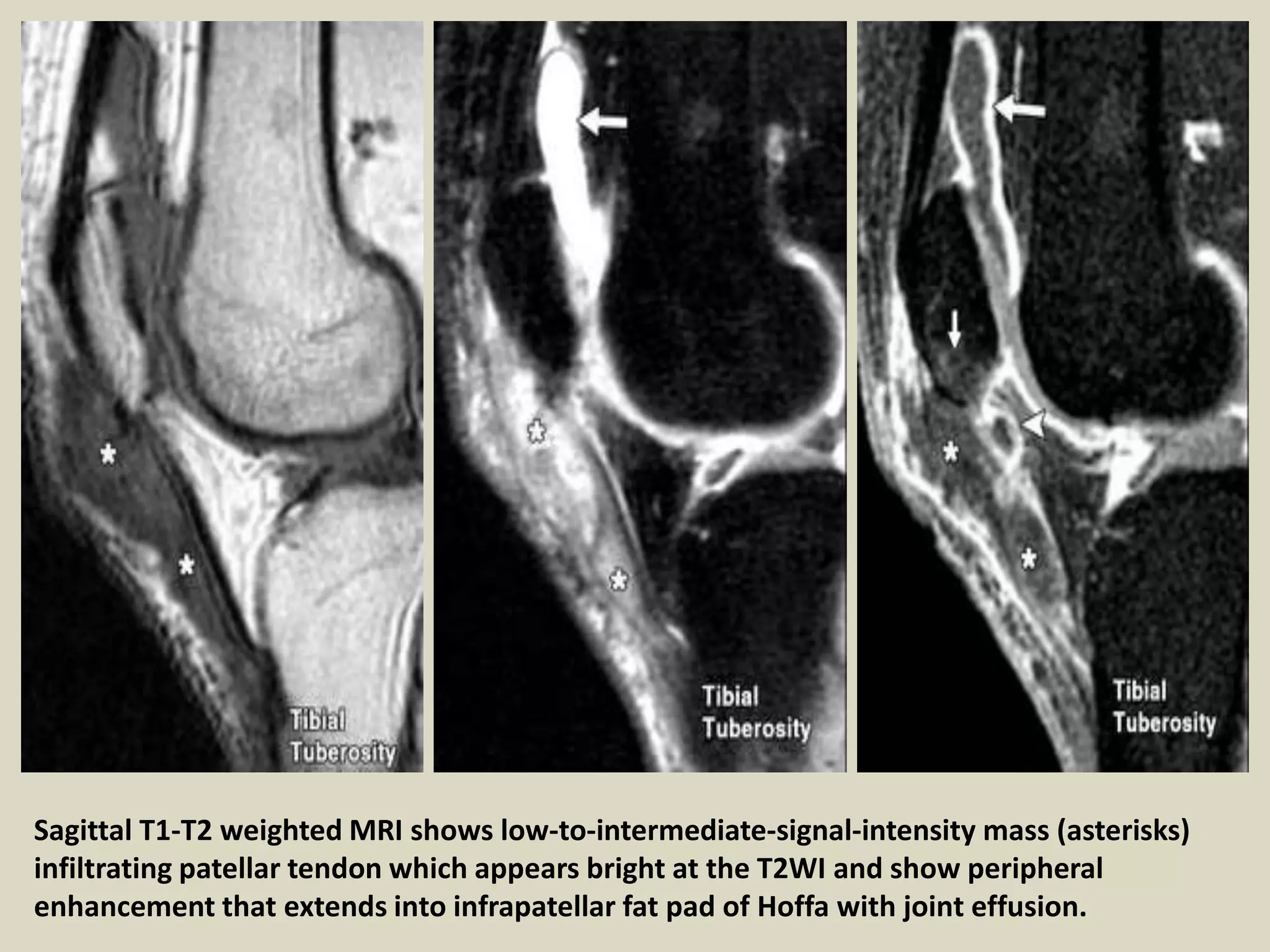 Presentation1.pptx, radiological imaging of gout disease. | PPTX