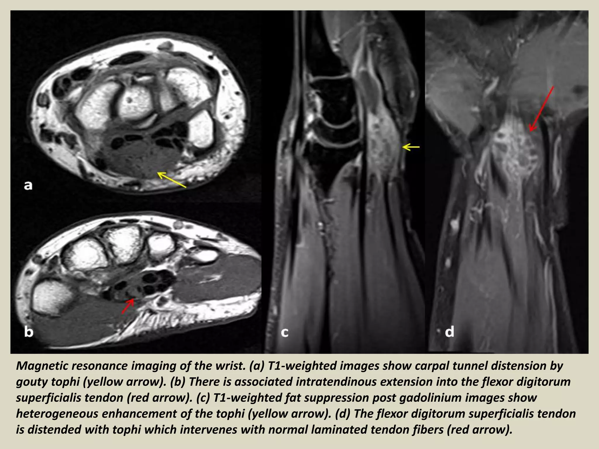 Presentation1.pptx, radiological imaging of gout disease. | PPTX