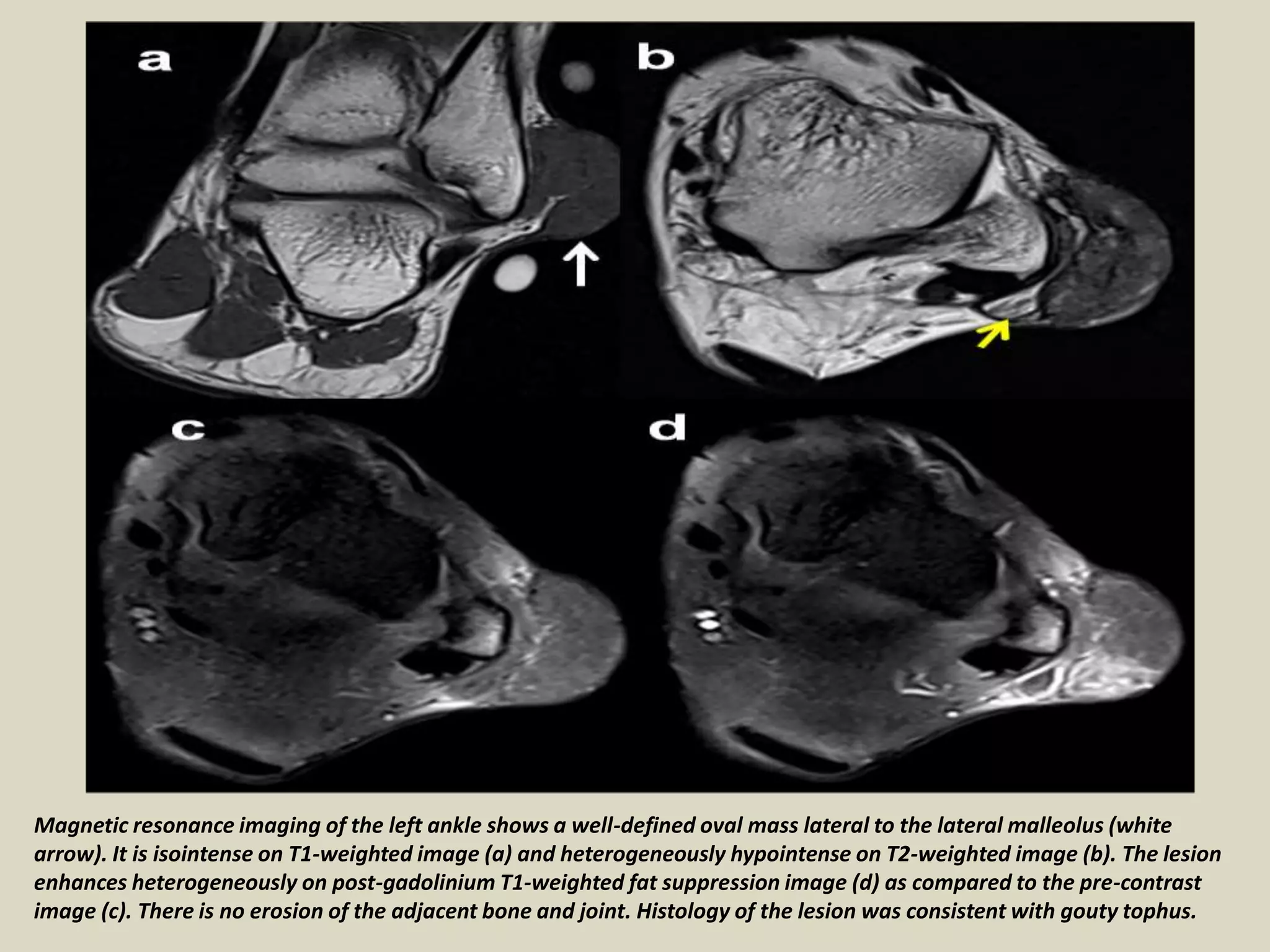 Presentation1.pptx, radiological imaging of gout disease. | PPTX