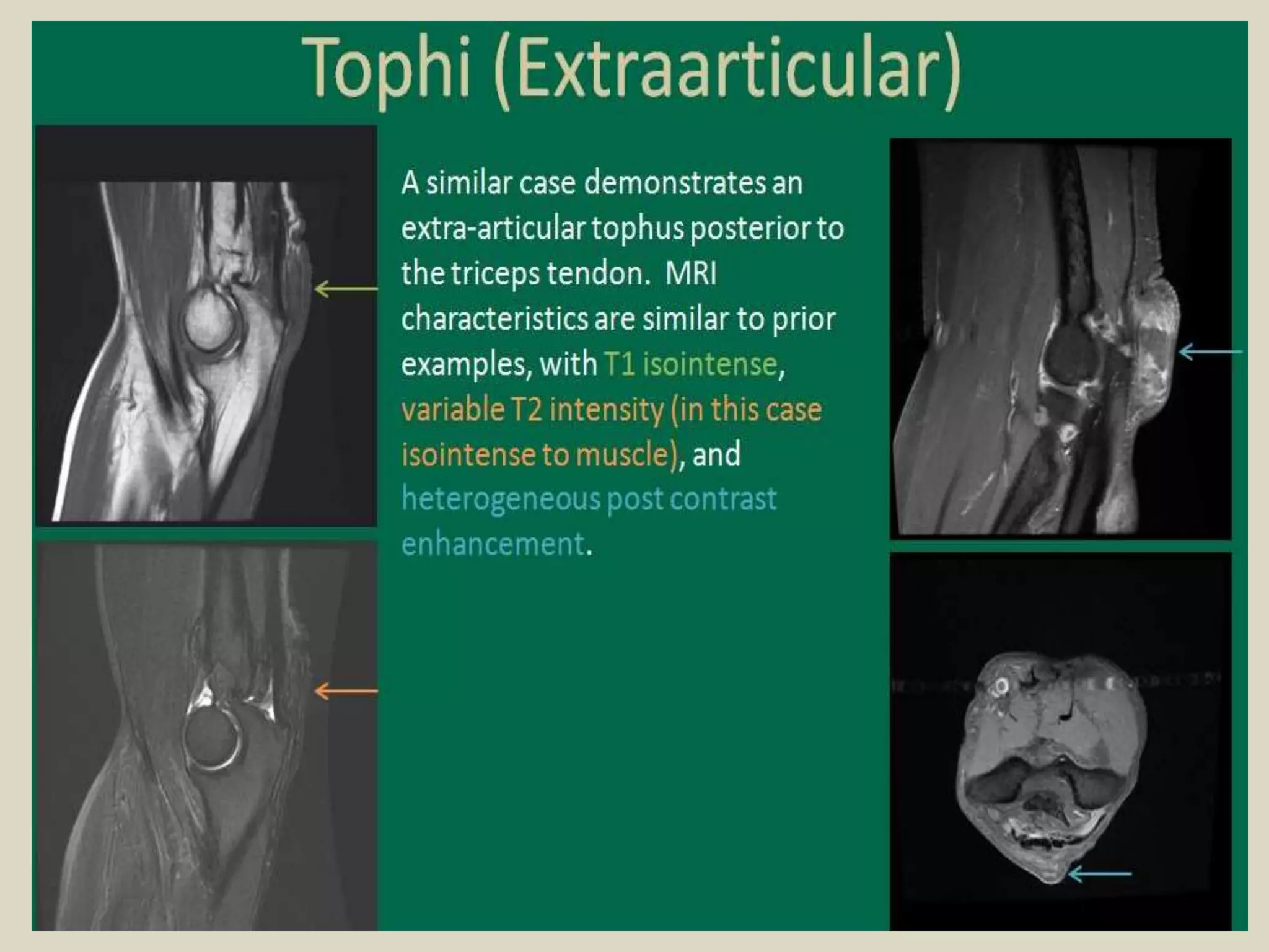 Presentation1.pptx, radiological imaging of gout disease. | PPTX