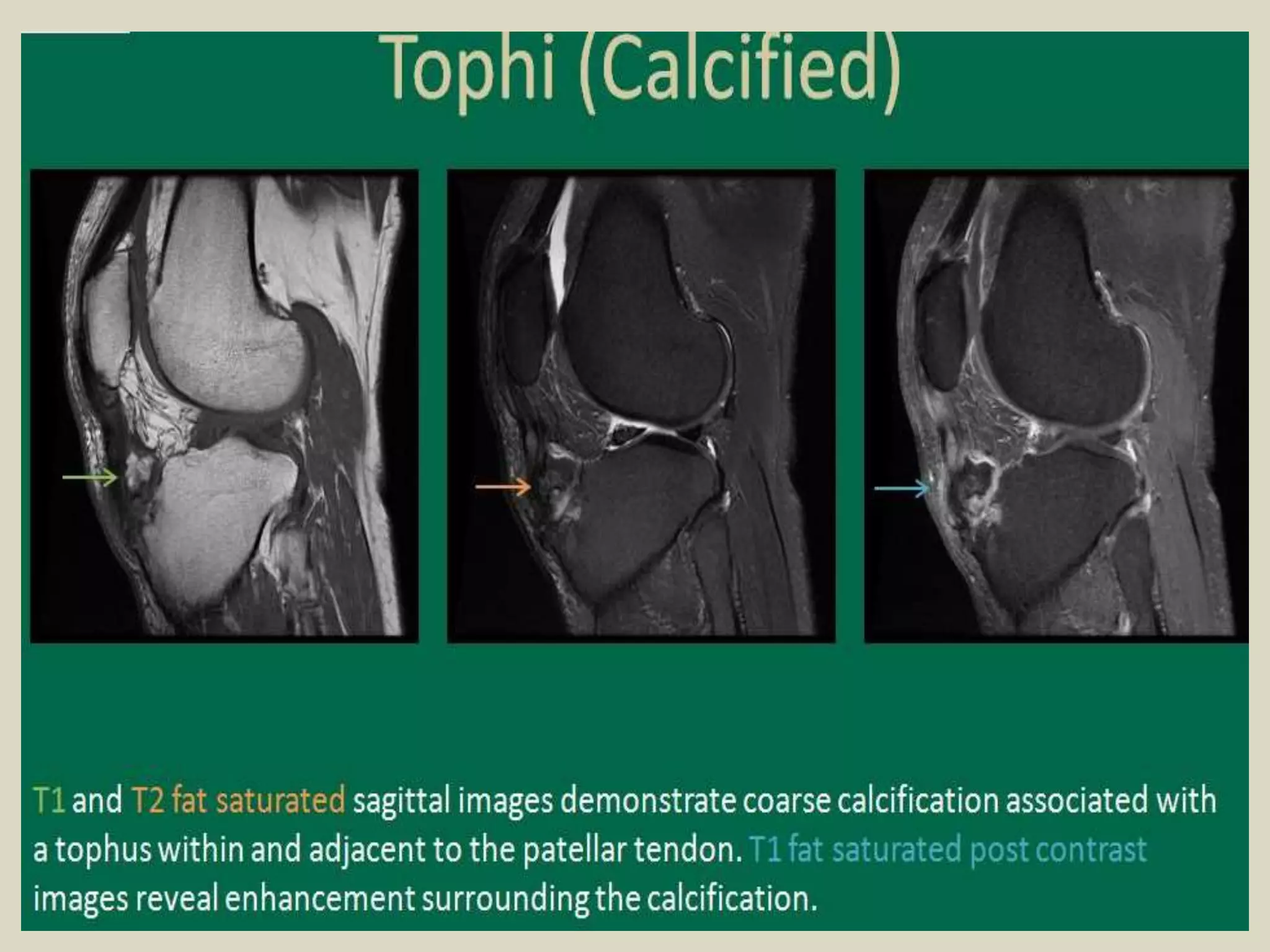 Presentation1.pptx, radiological imaging of gout disease. | PPTX