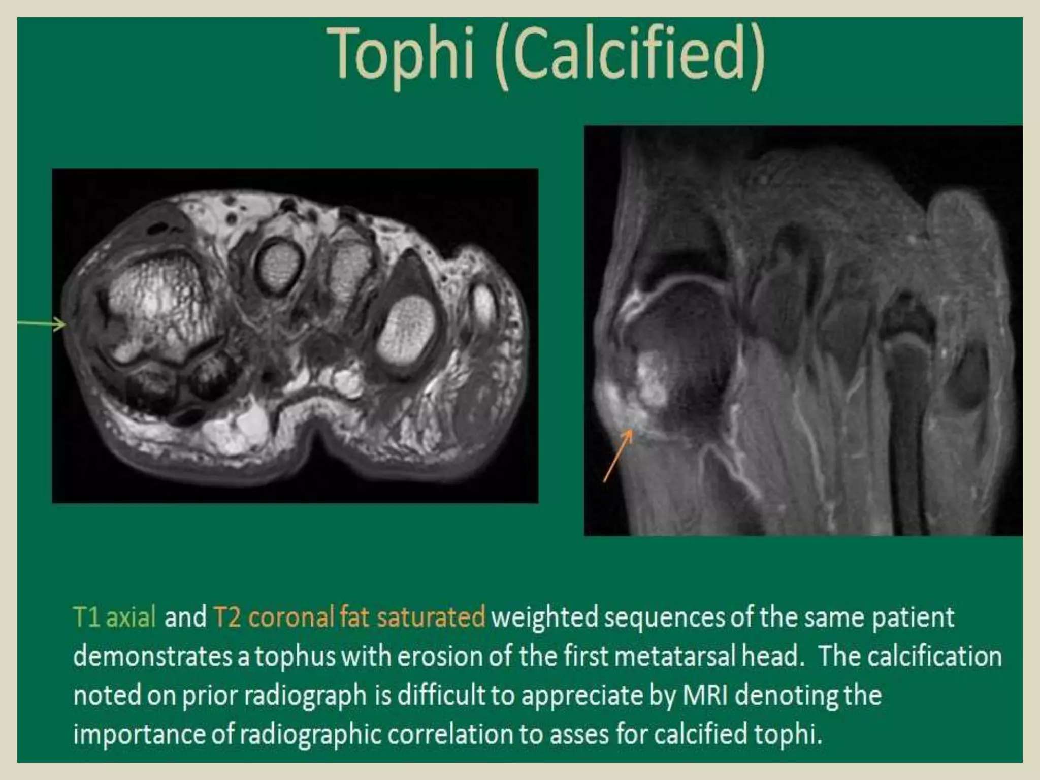 Presentation1.pptx, radiological imaging of gout disease. | PPTX