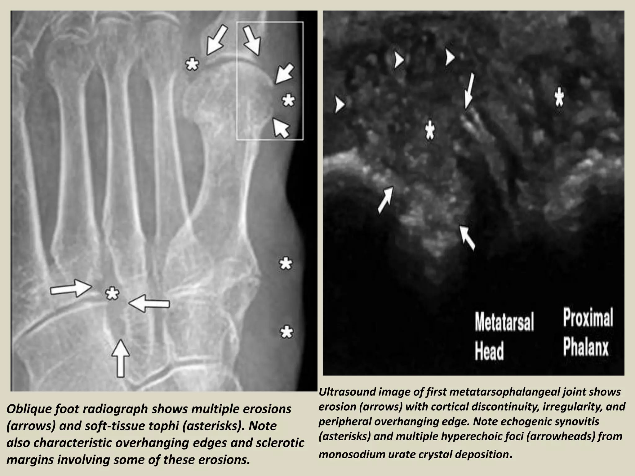 Presentation1.pptx, radiological imaging of gout disease. | PPTX