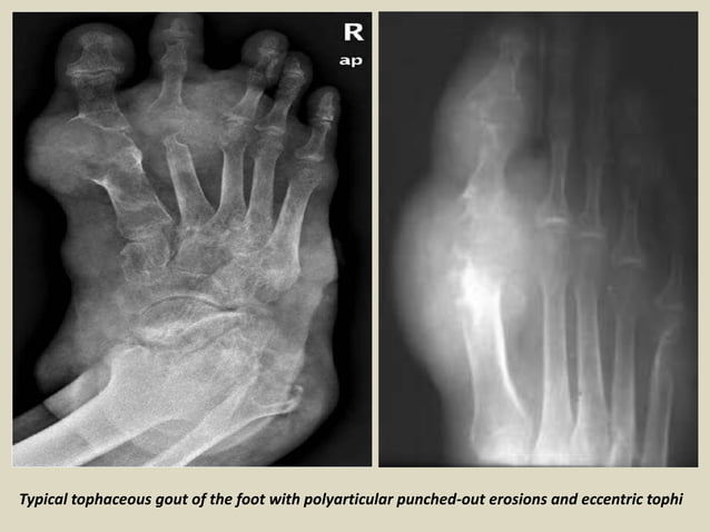 Presentation1.pptx, radiological imaging of gout disease. | PPTX