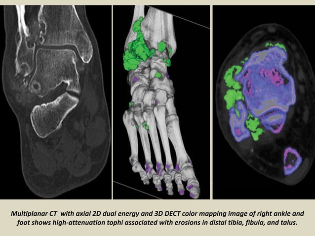 Presentation1.pptx, radiological imaging of gout disease. | PPTX