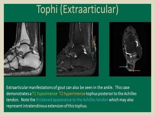 Tophus Achilles