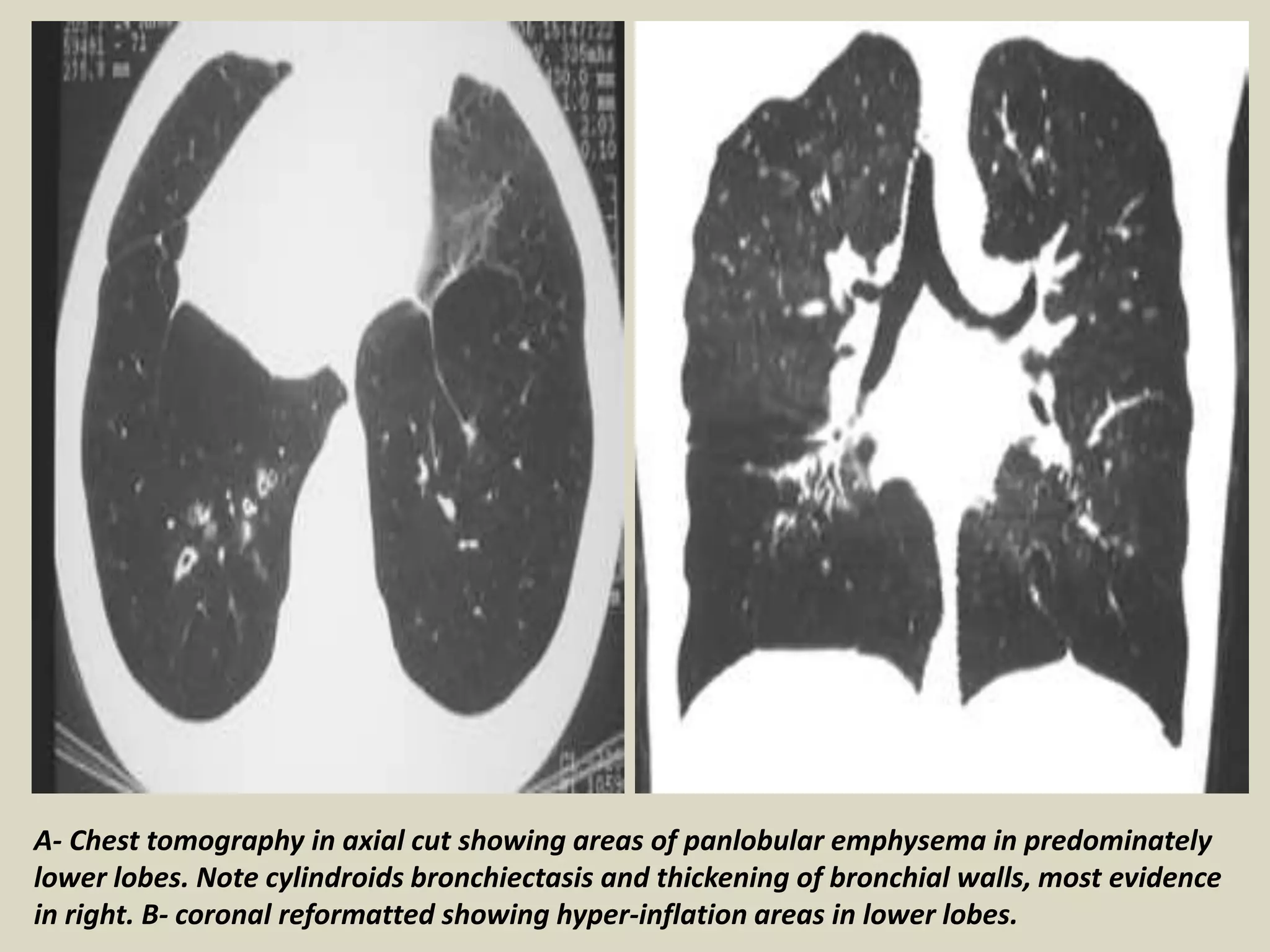 Presentation1.pptx, radiological imaging of chronic obstructive airway ...