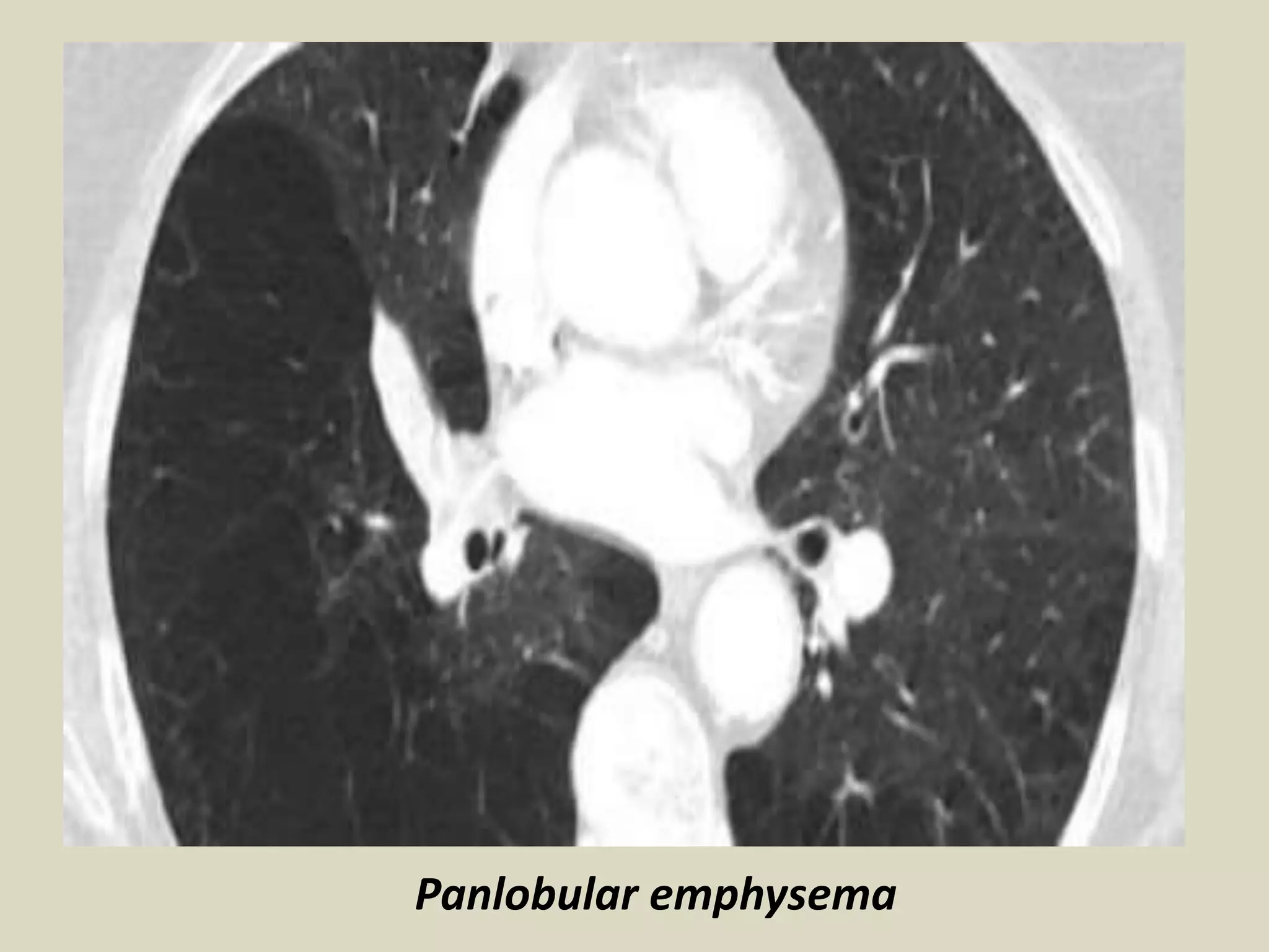 Presentation1.pptx, radiological imaging of chronic obstructive airway ...