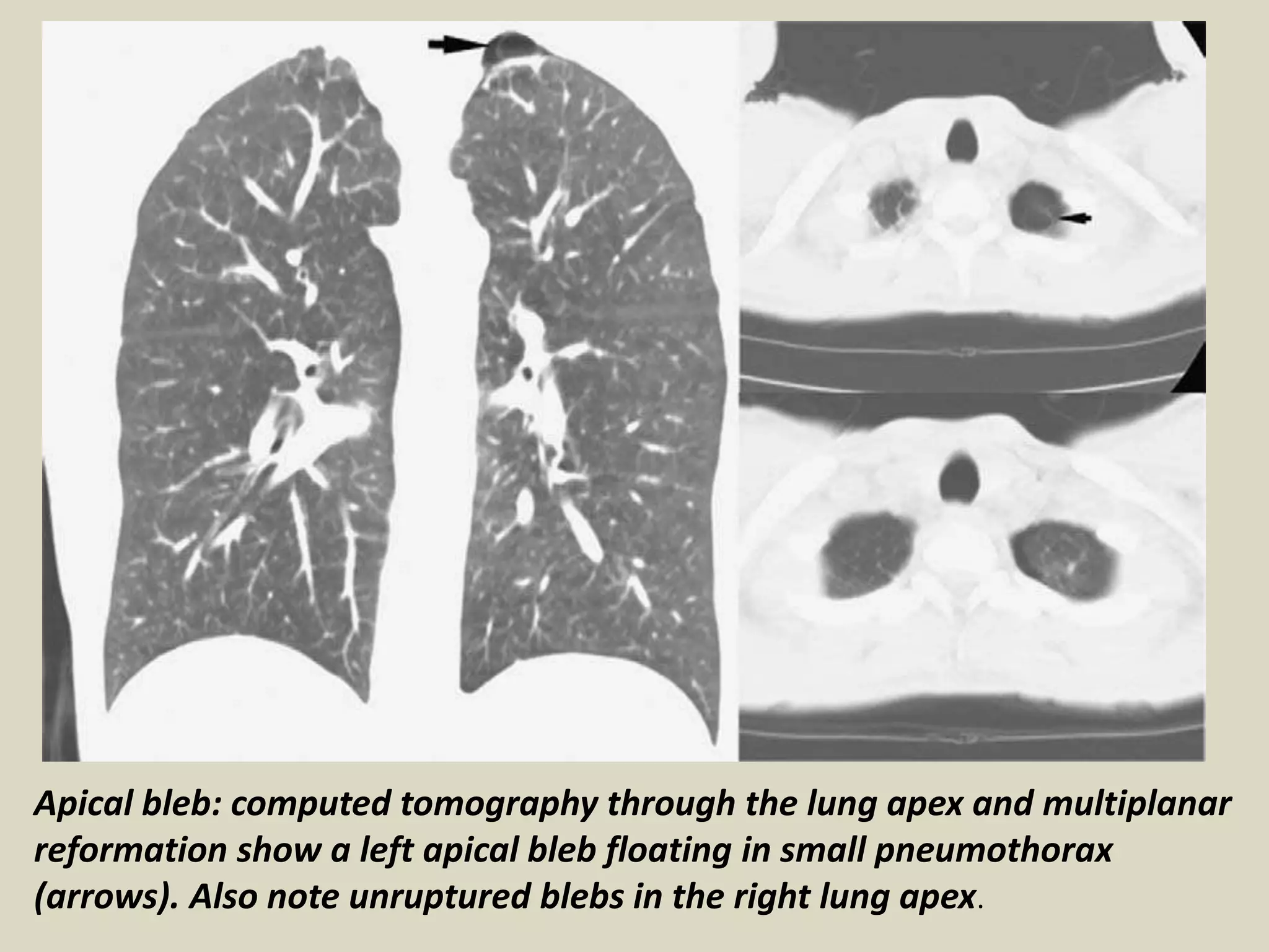 Presentation1.pptx, radiological imaging of chronic obstructive airway ...