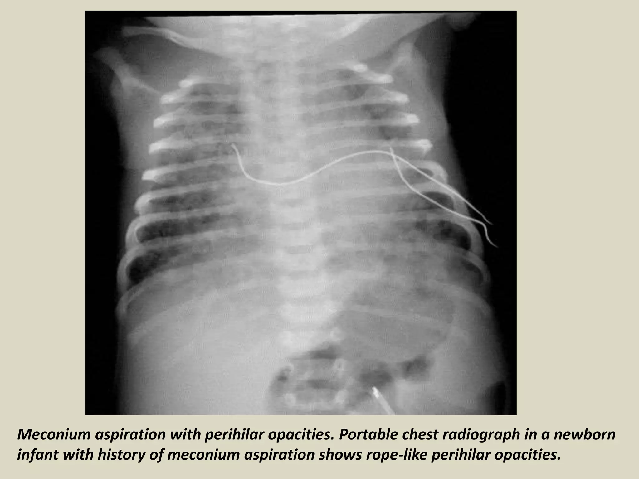 Presentation1.pptx, radiological imaging of neonatal lung disease. | PPTX