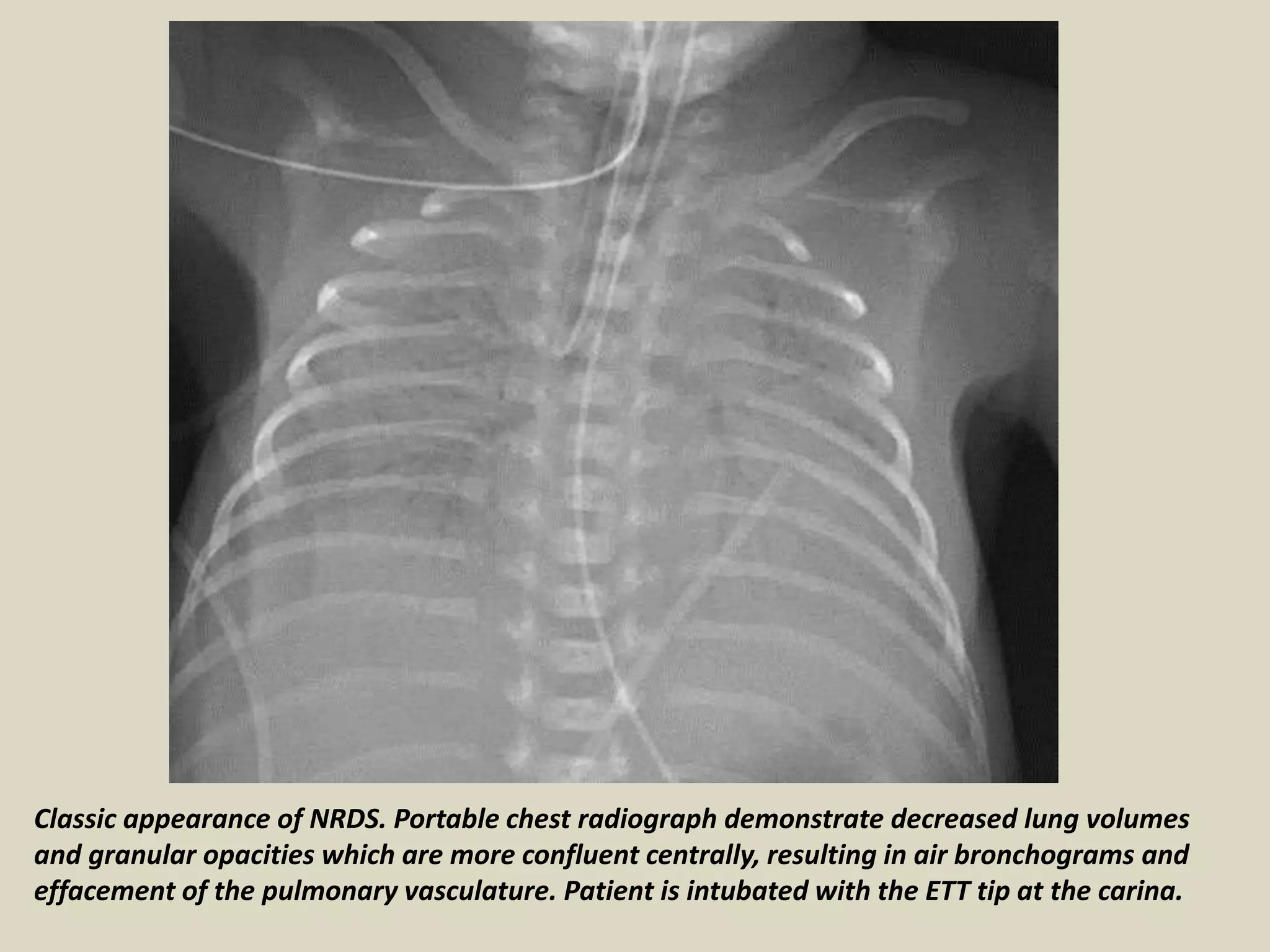 Presentation1.pptx, radiological imaging of neonatal lung disease. | PPTX