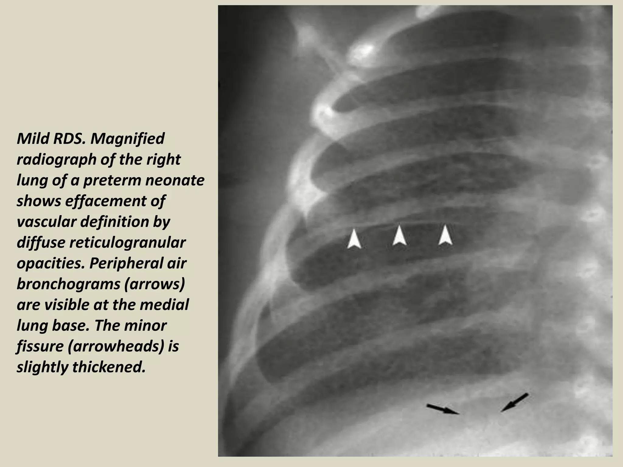 Presentation1.pptx, radiological imaging of neonatal lung disease. | PPTX