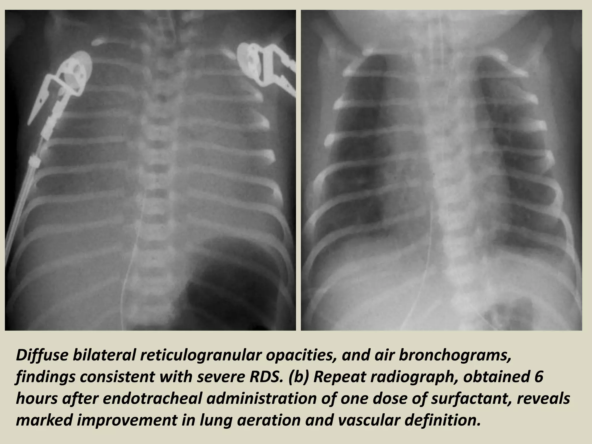 Presentation1.pptx, radiological imaging of neonatal lung disease. | PPTX