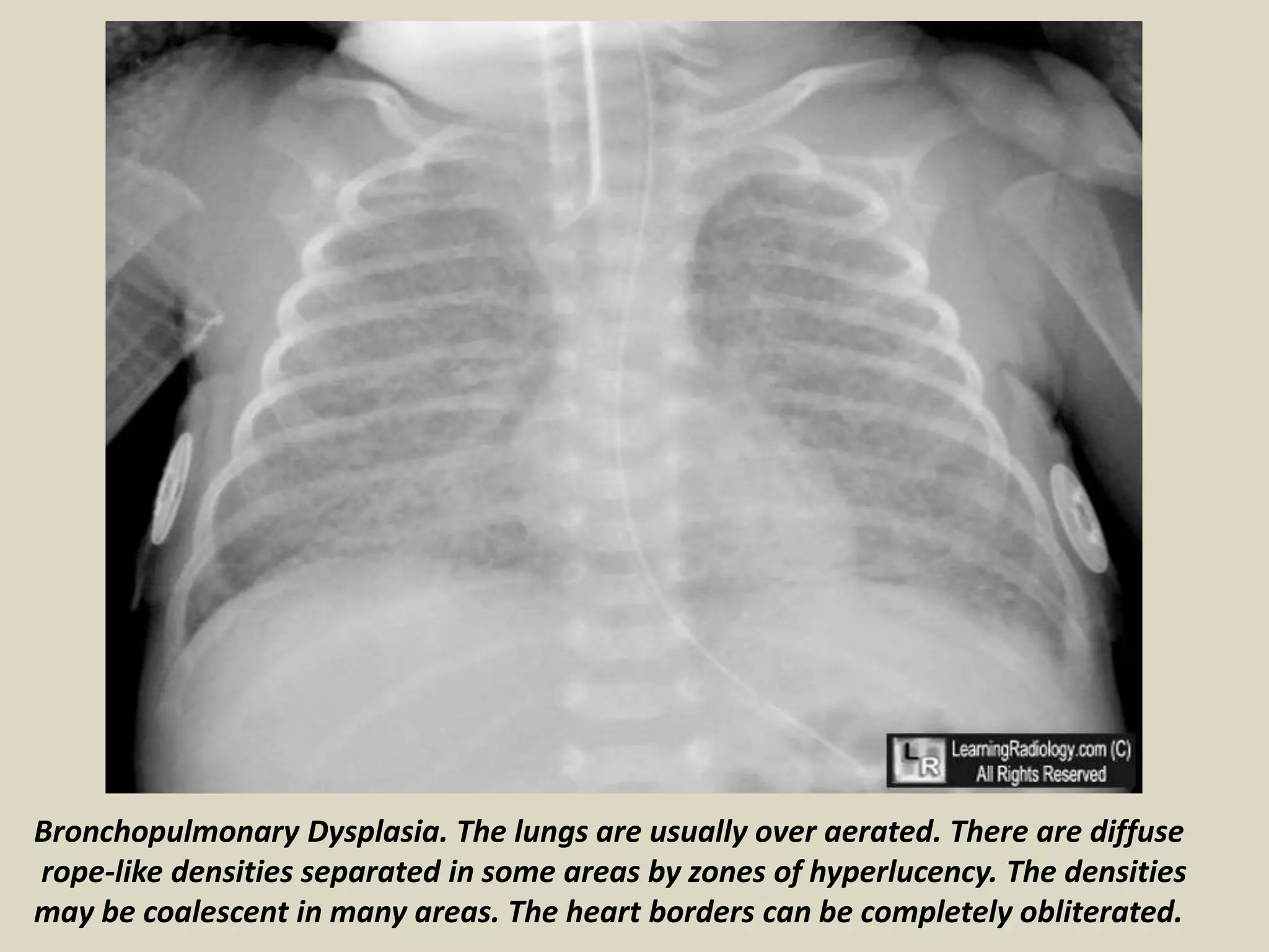 Presentation1.pptx, radiological imaging of neonatal lung disease. | PPTX
